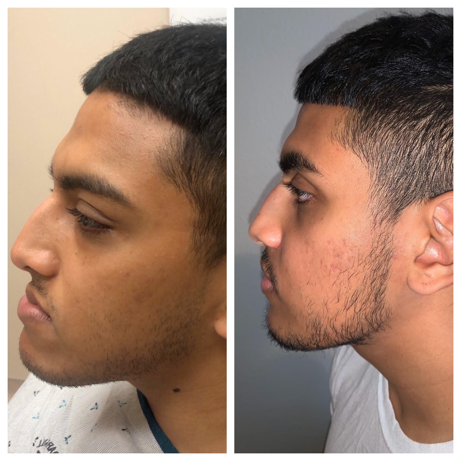 2 Months Post-Op. Double Jaw Surgery | Scrolller