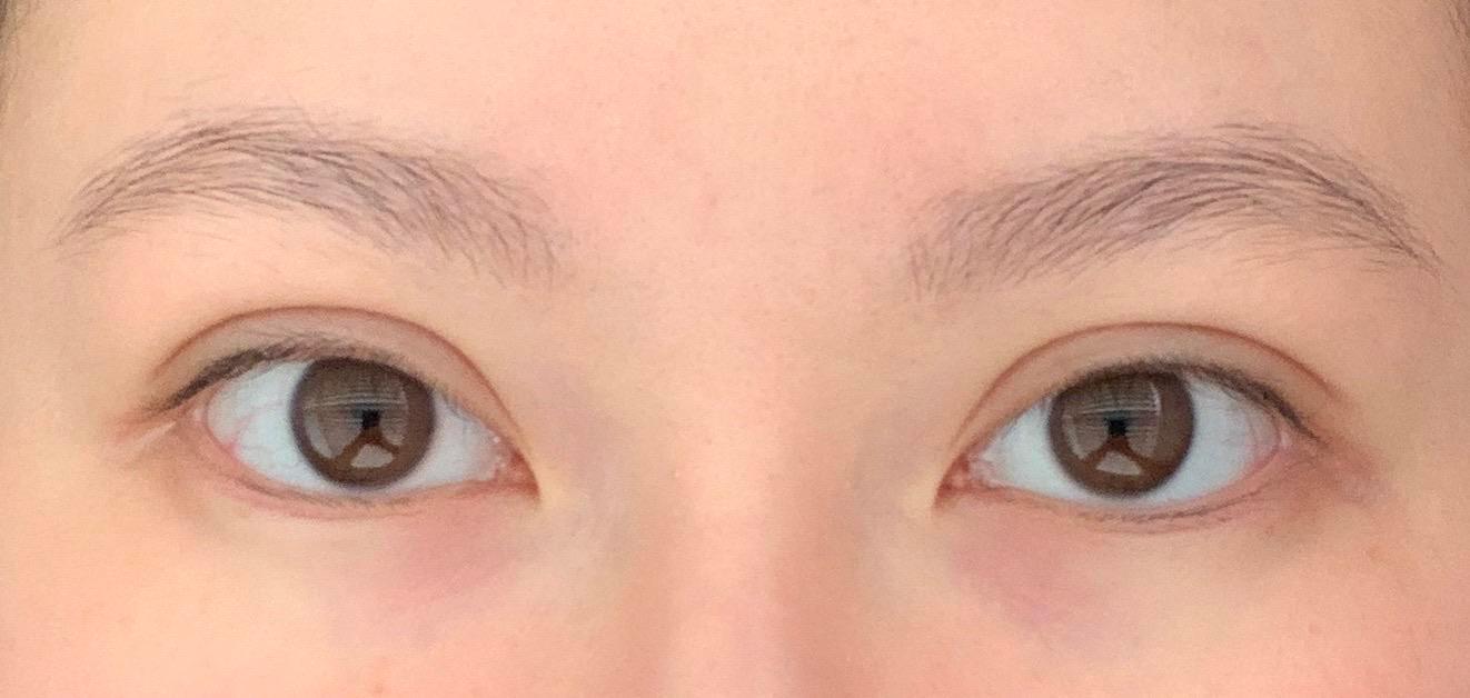 3 week post op: Asian blepharoplasty, uneven eyes? | Scrolller