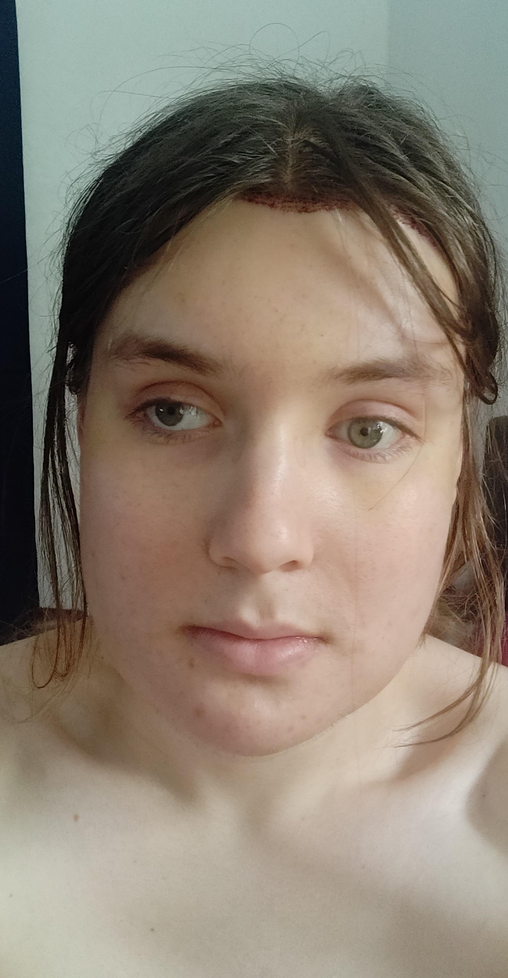 4 days postop FFS with Dr. Alexander Sinclair in LA | Scrolller