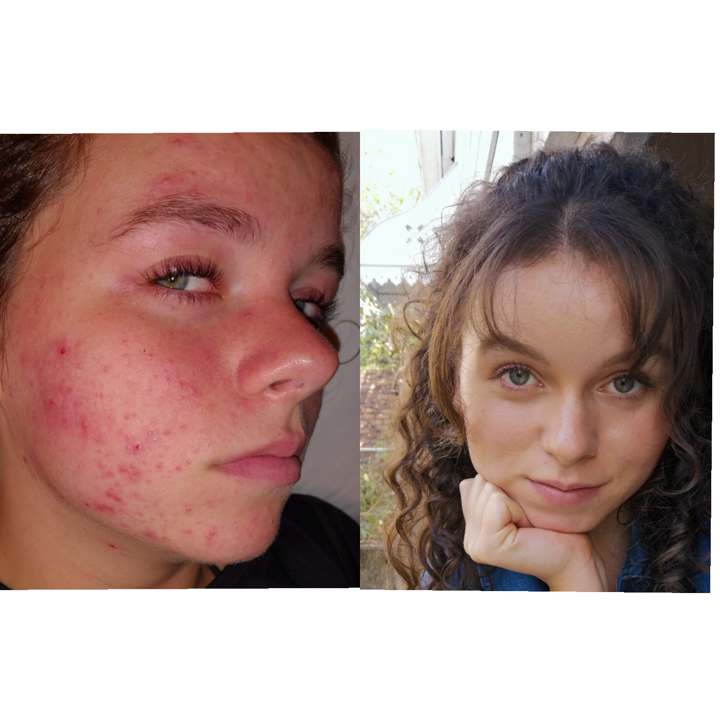 5 months AHA and BHA transformation | Scrolller