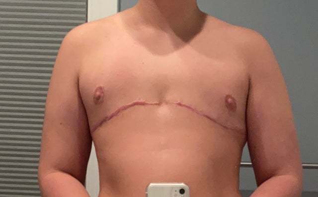 6 months post op | Scrolller