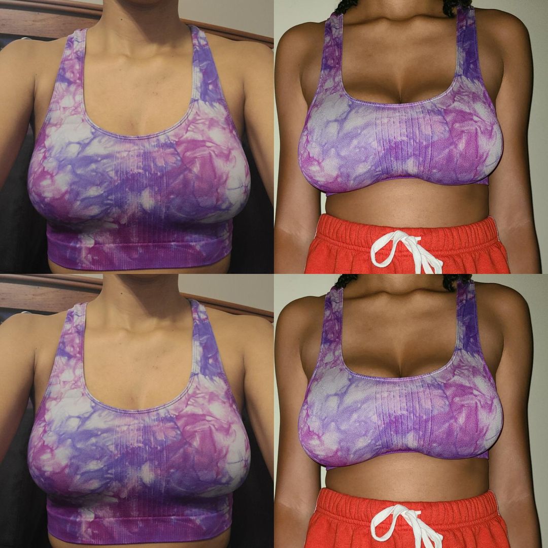 7 weeks post op. From J to DD. :) | Scrolller