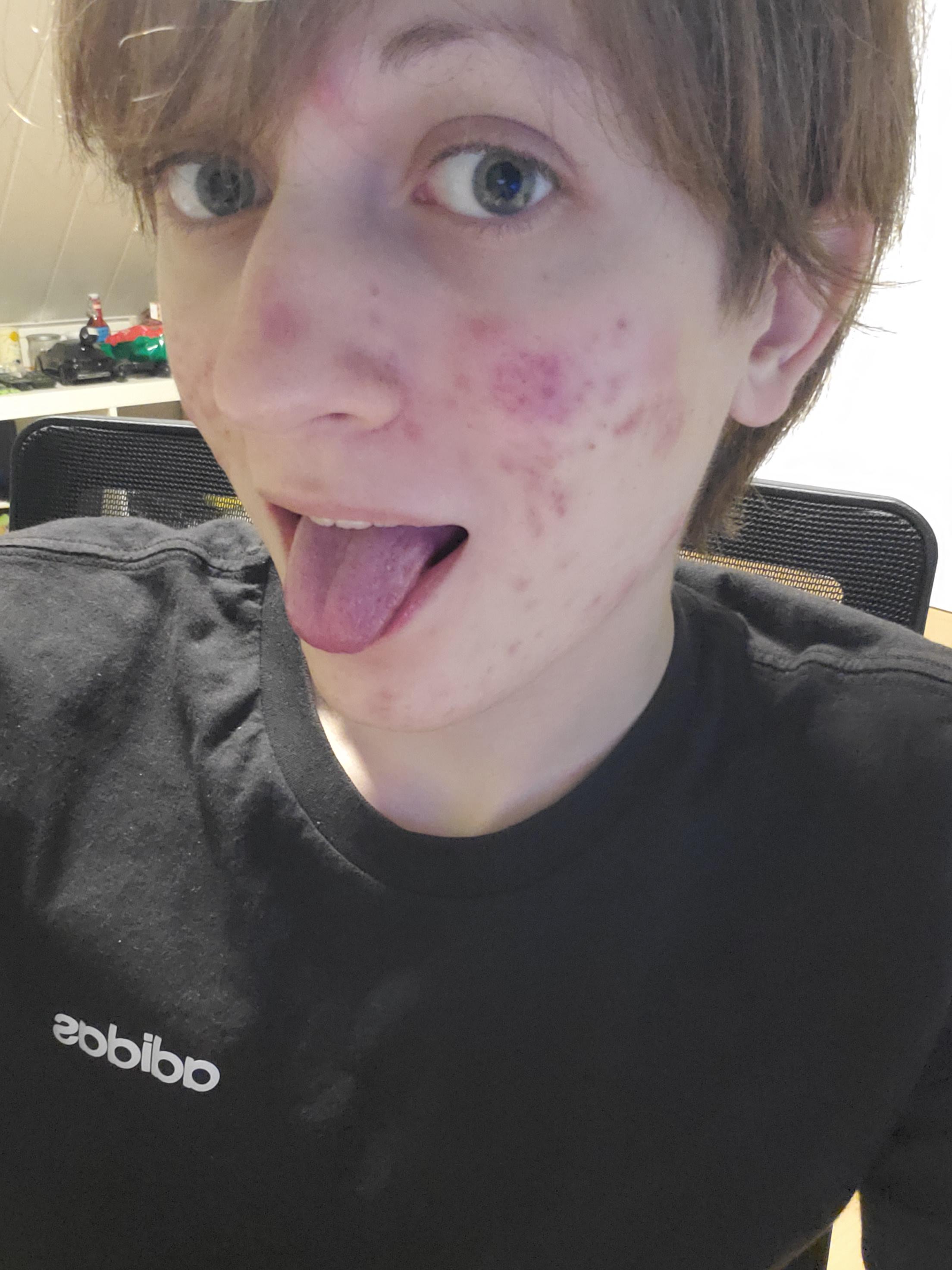 Acne... Still cute? :( | Scrolller