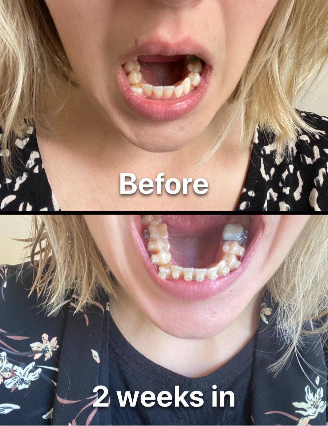 Already seeing some progress 2 weeks in! | Scrolller