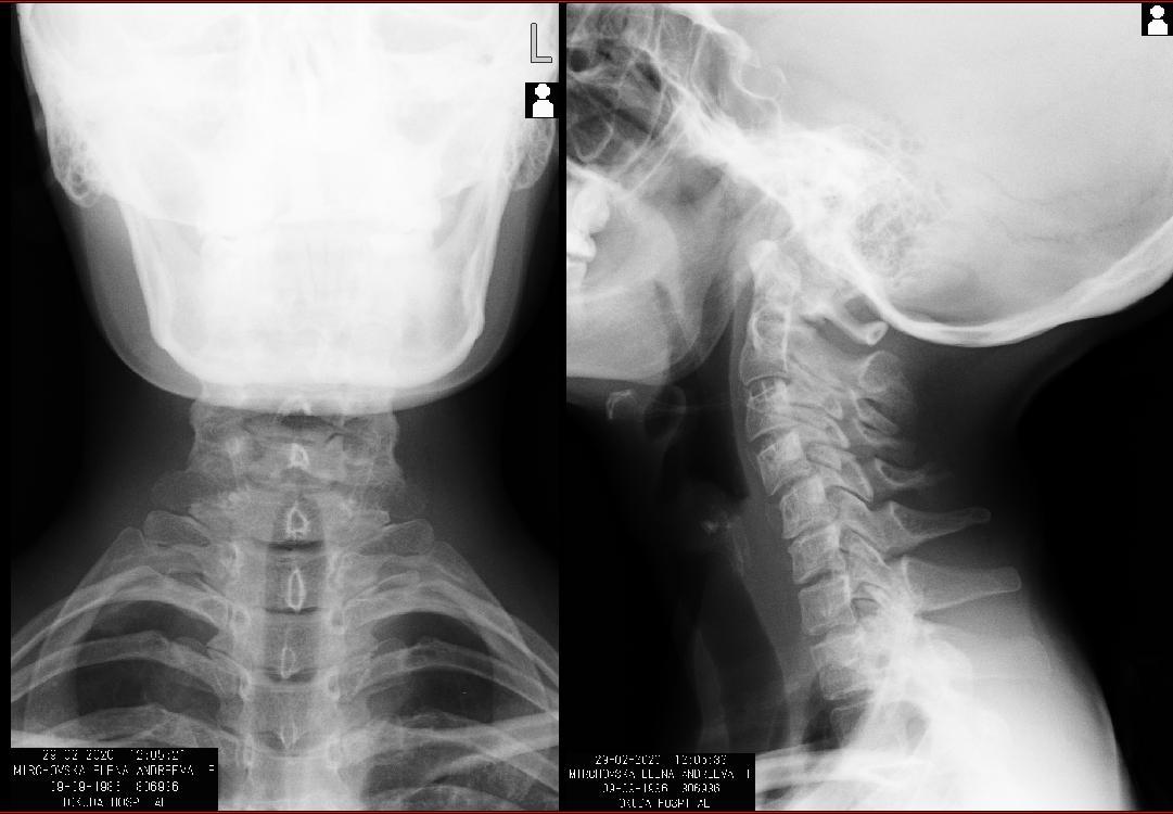 Back with proper neck x-rays of... neck_pain.jpg | Scrolller