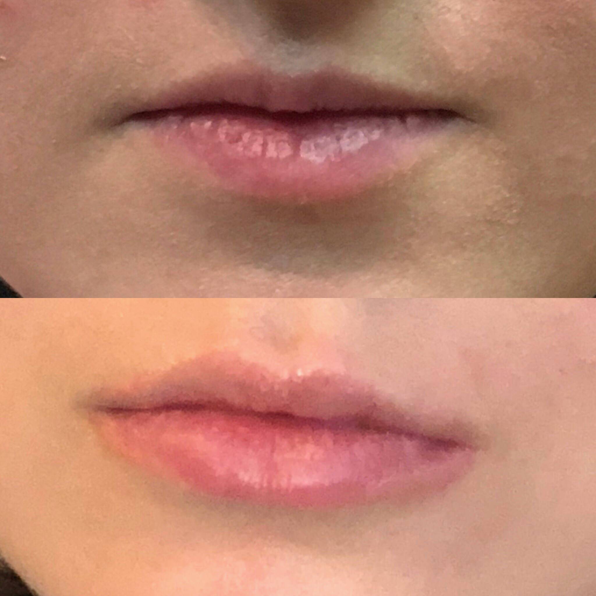 Before - After 2 syringes - I want MORE! | Scrolller