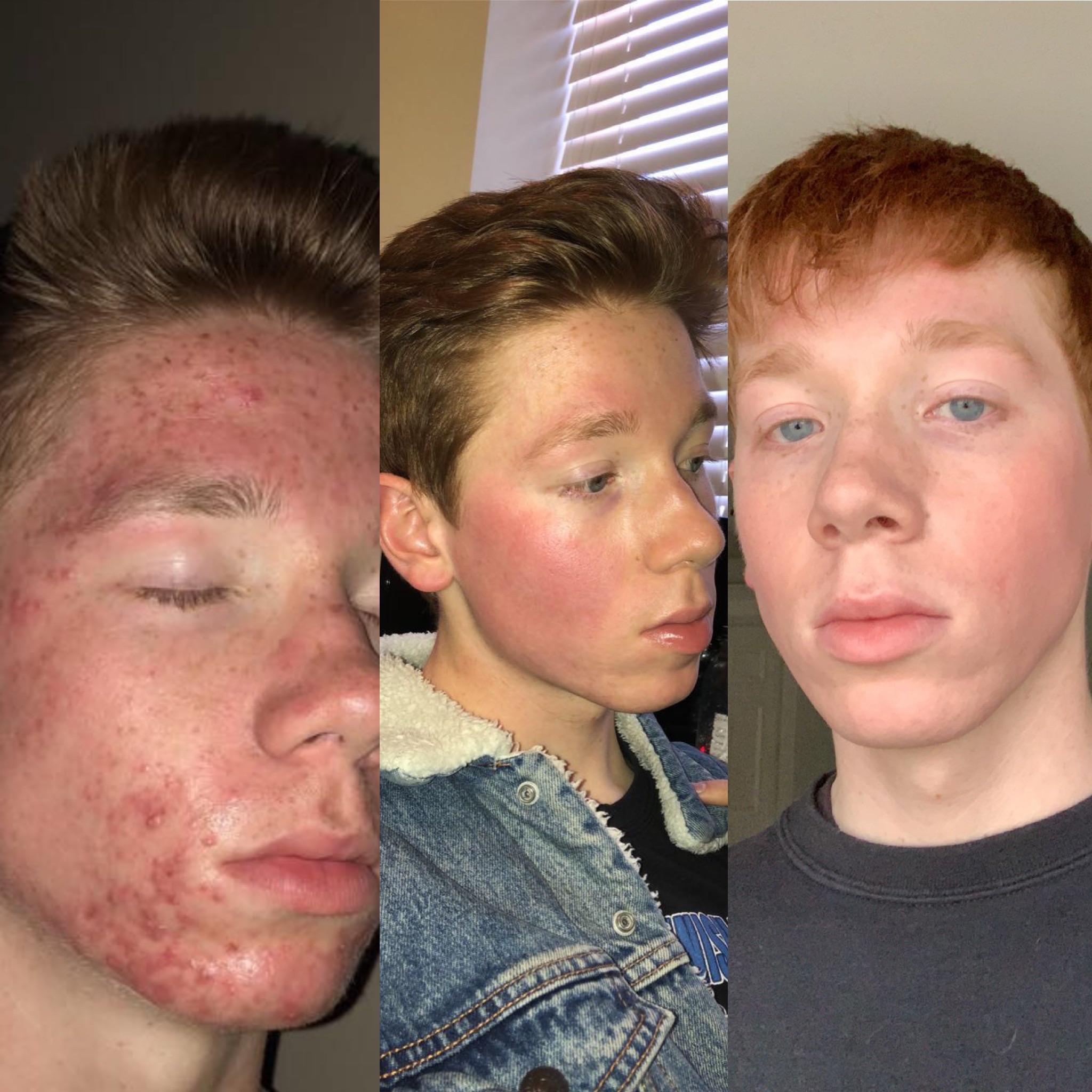 Before. During. After. Accutane Might Turn You Into An Eboy... | Scrolller