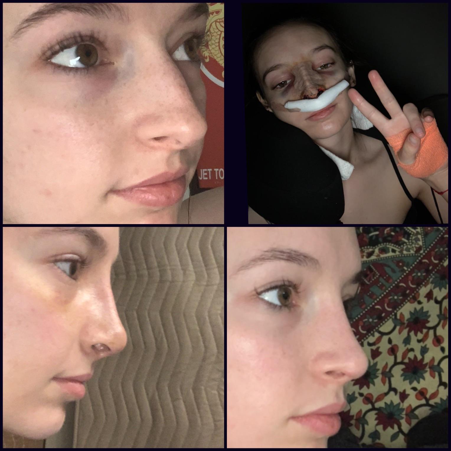 Before —> 1 Day Post Op —> 1 Week Post Op (immediately after cast removal) —> Today, 3 Months ...