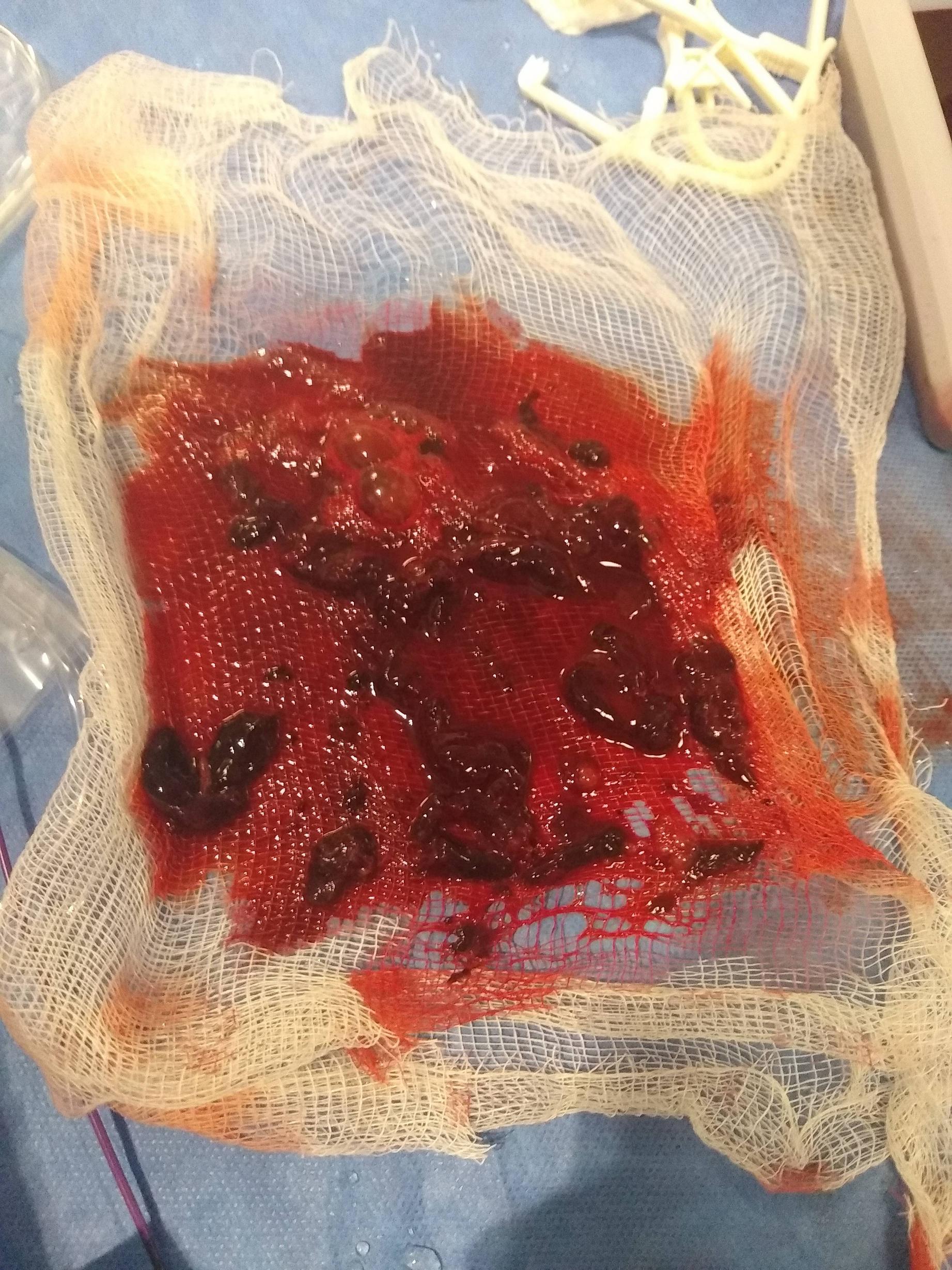 Blood clots we snagged out of a patients right lung today. | Scrolller