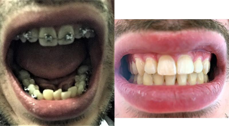 Braces Came Off Today Lets Rejoice After 19 Months Of Treatment