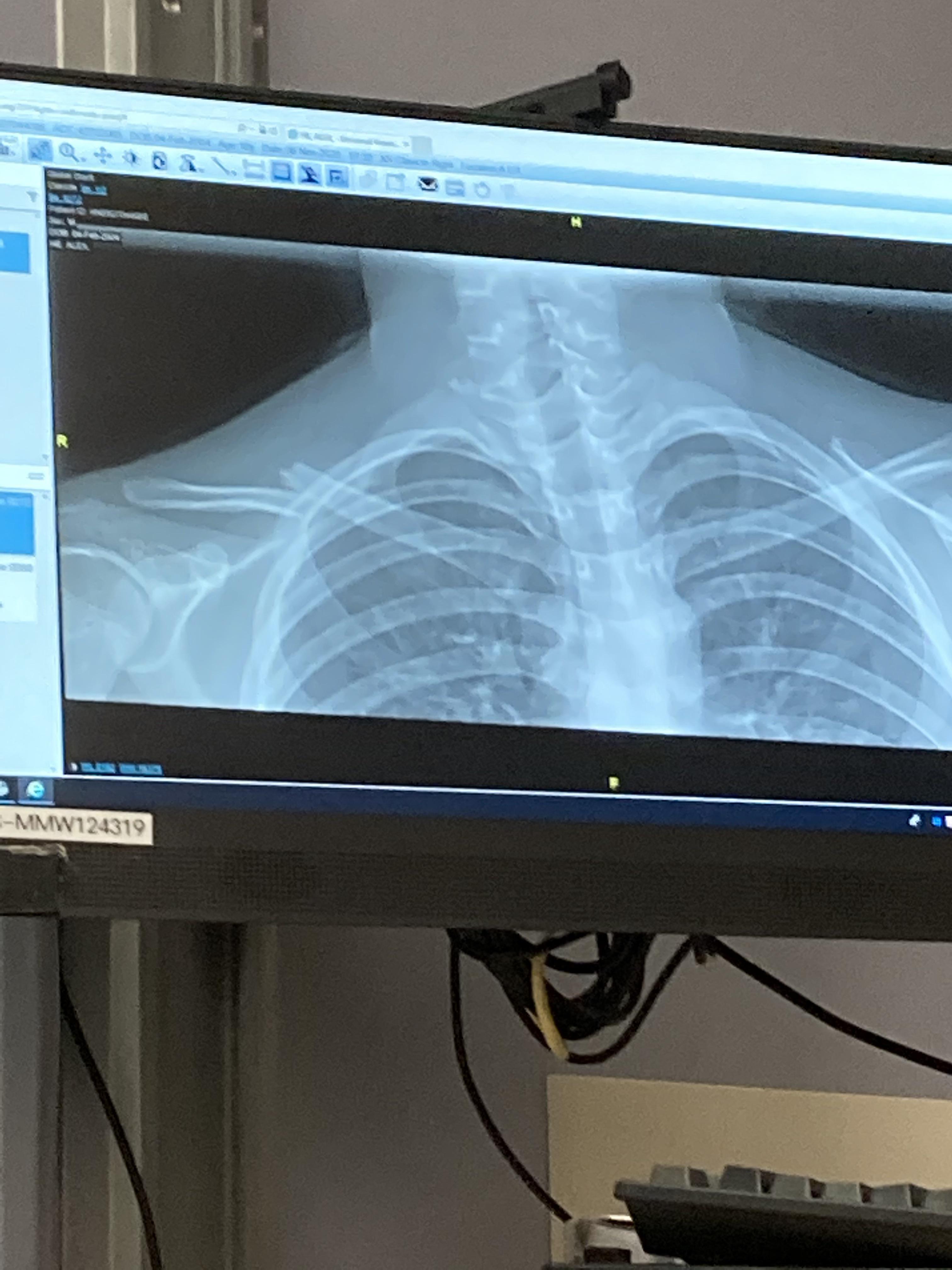 Broke my right collarbone. Looks like NNN is gonna be easy this year. | Scrolller