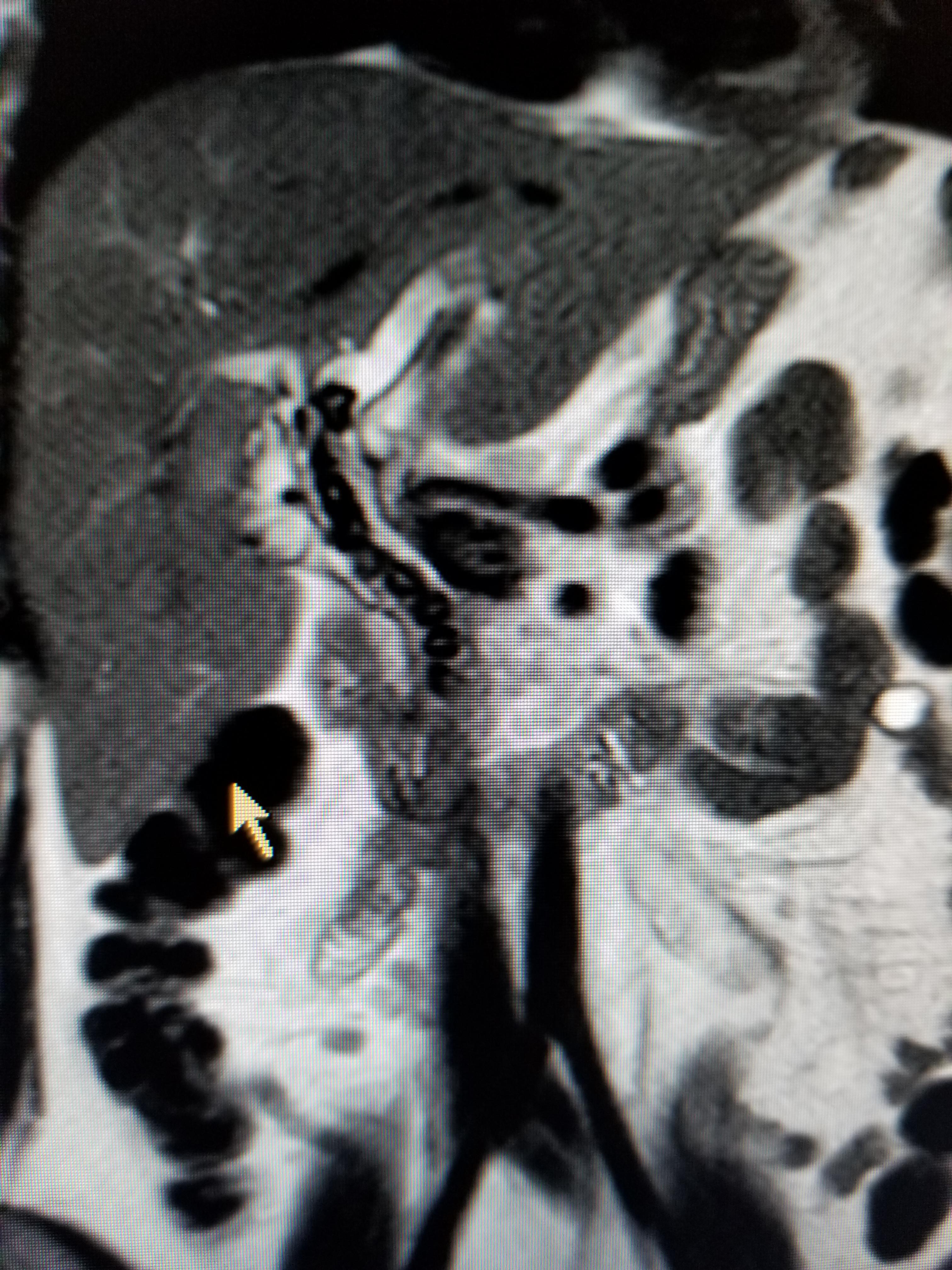 Check out the biliary stones | Scrolller