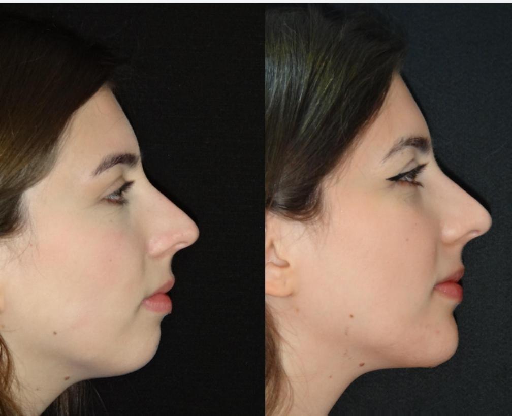 Chin implant 2 weeks post op | Scrolller