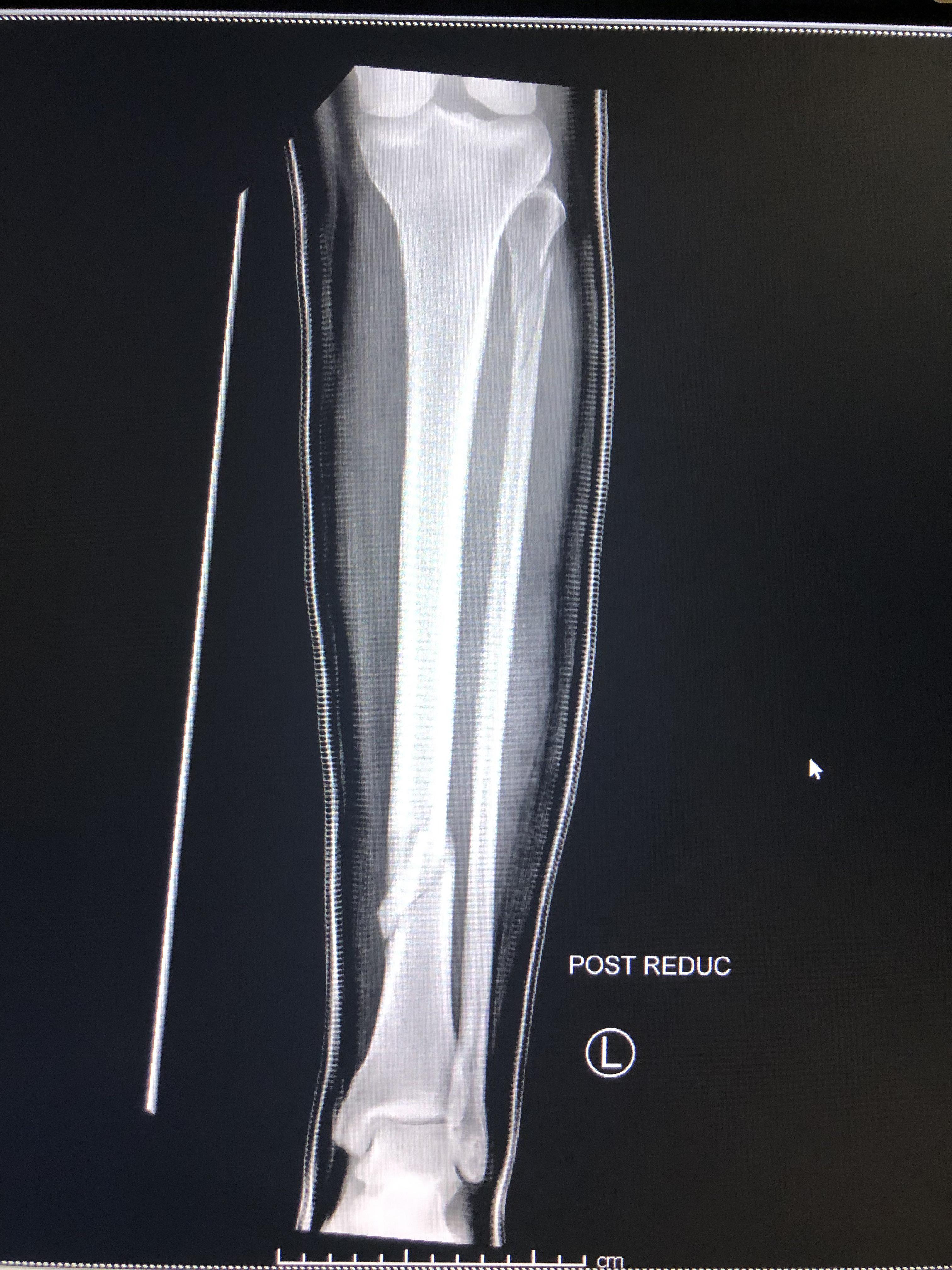 Closed displaced spiral fracture tibia, closed fracture of fibula | Scrolller