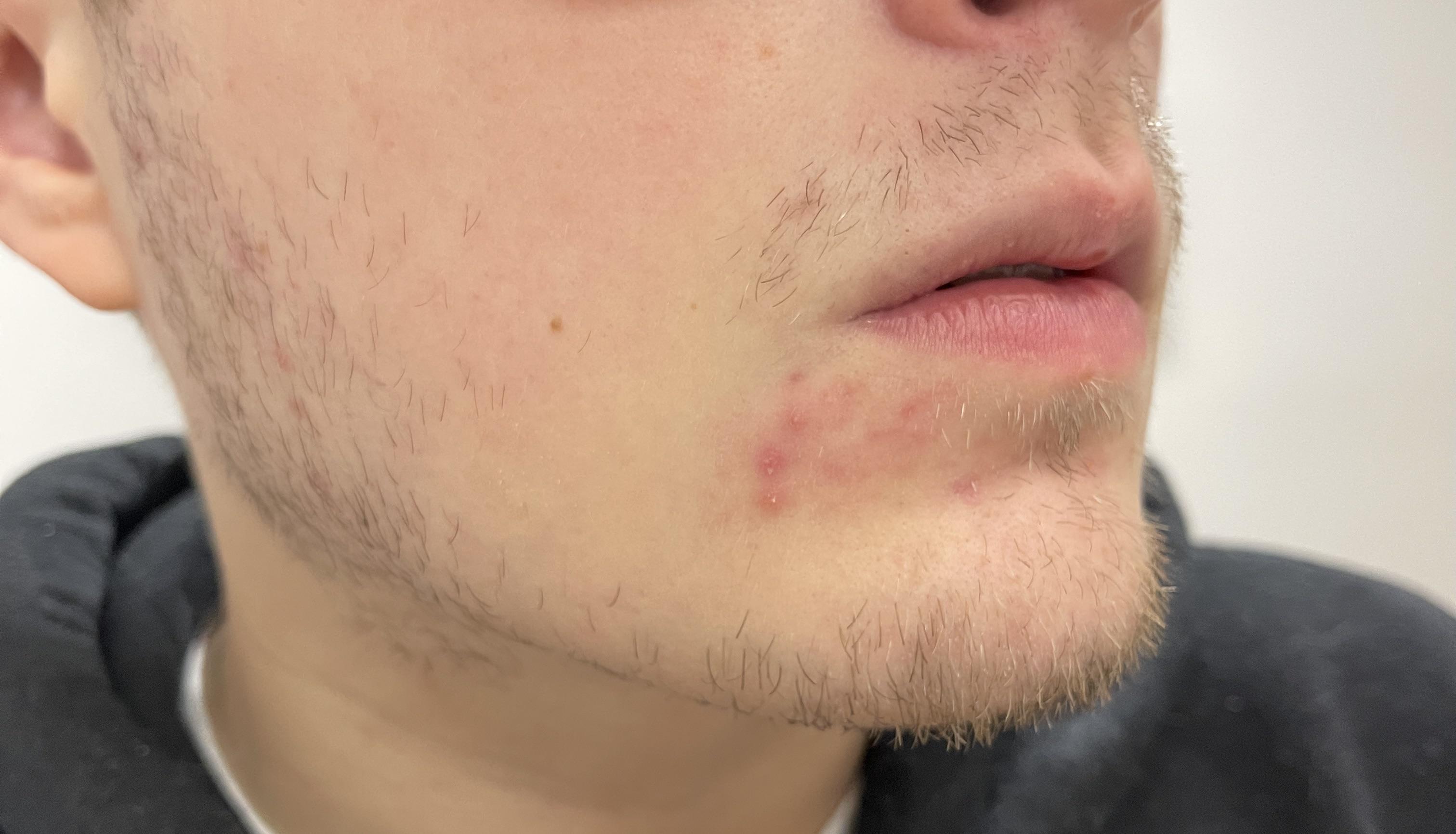 Cold sores or just Acne? | Scrolller