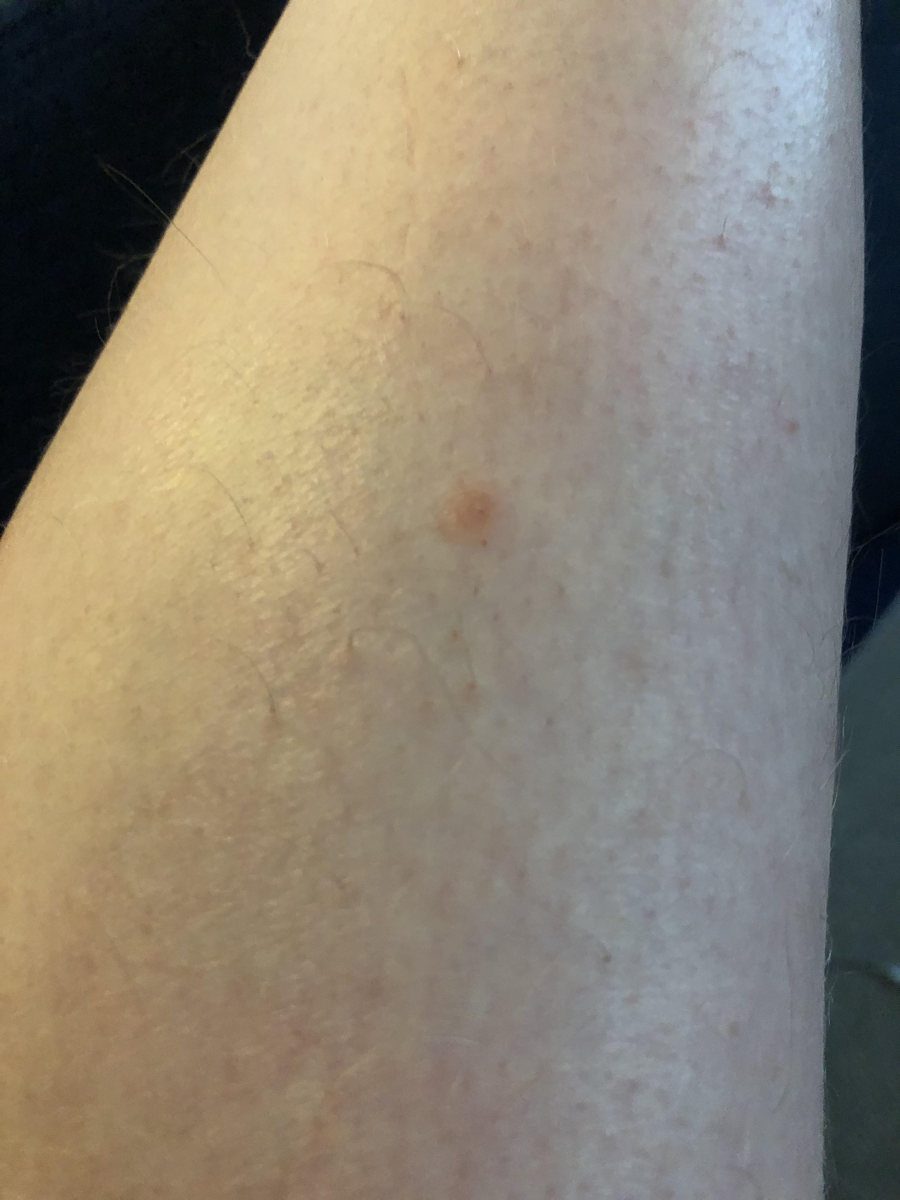 Derm said spot was KP? | Scrolller