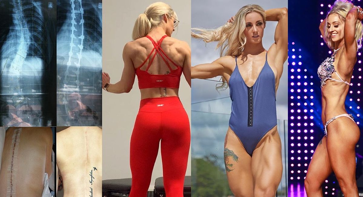 Diagnosed at 14, fused at 18, first bodybuilding show at 29. | Scrolller