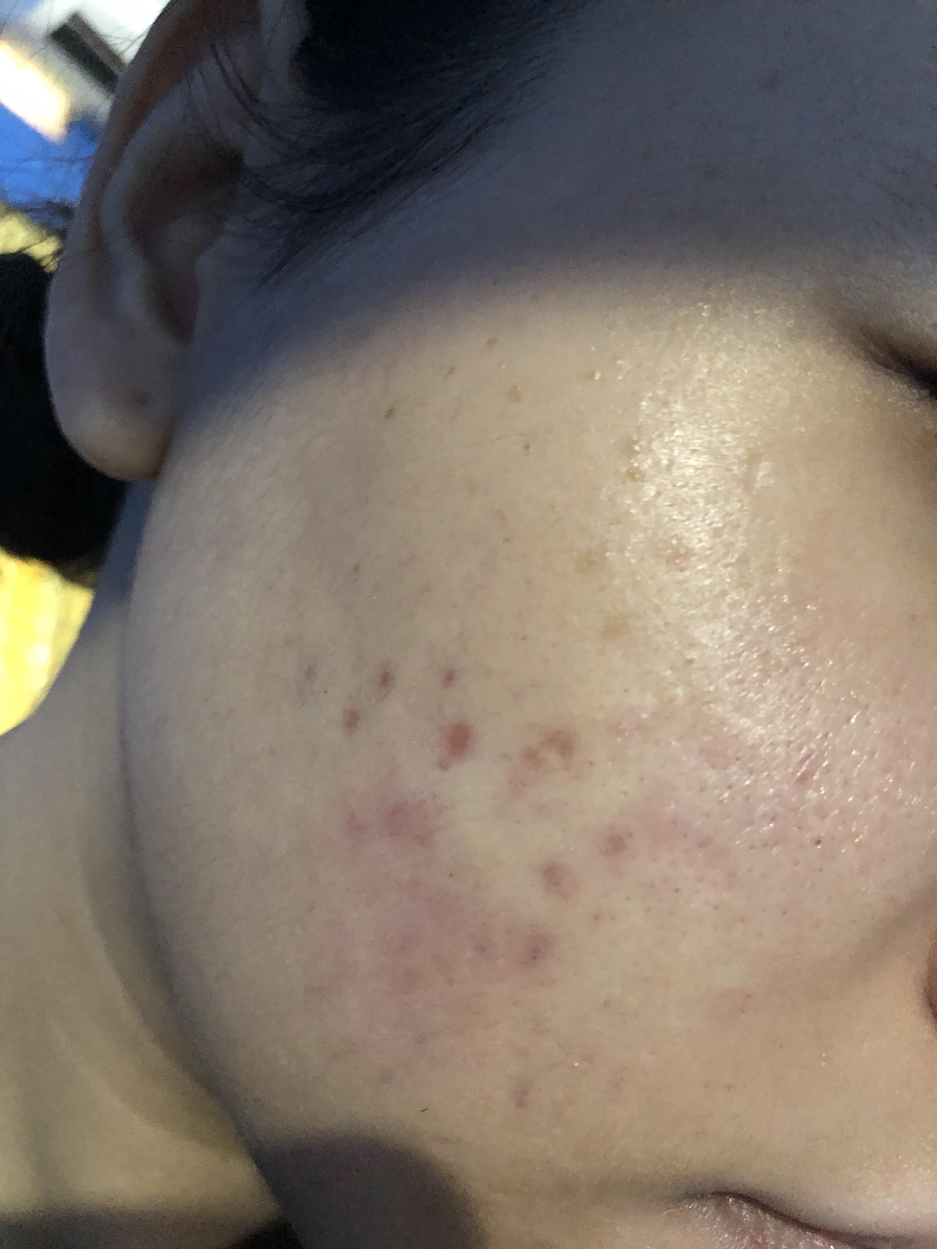 Does Someone Know What is the Red Spot on My Lower Cheek? | Scrolller