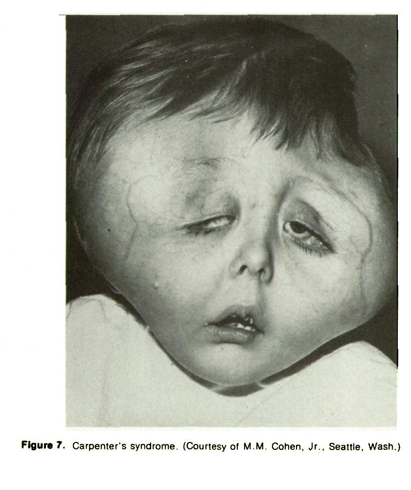 Extreme Carpenter Syndrome | Scrolller