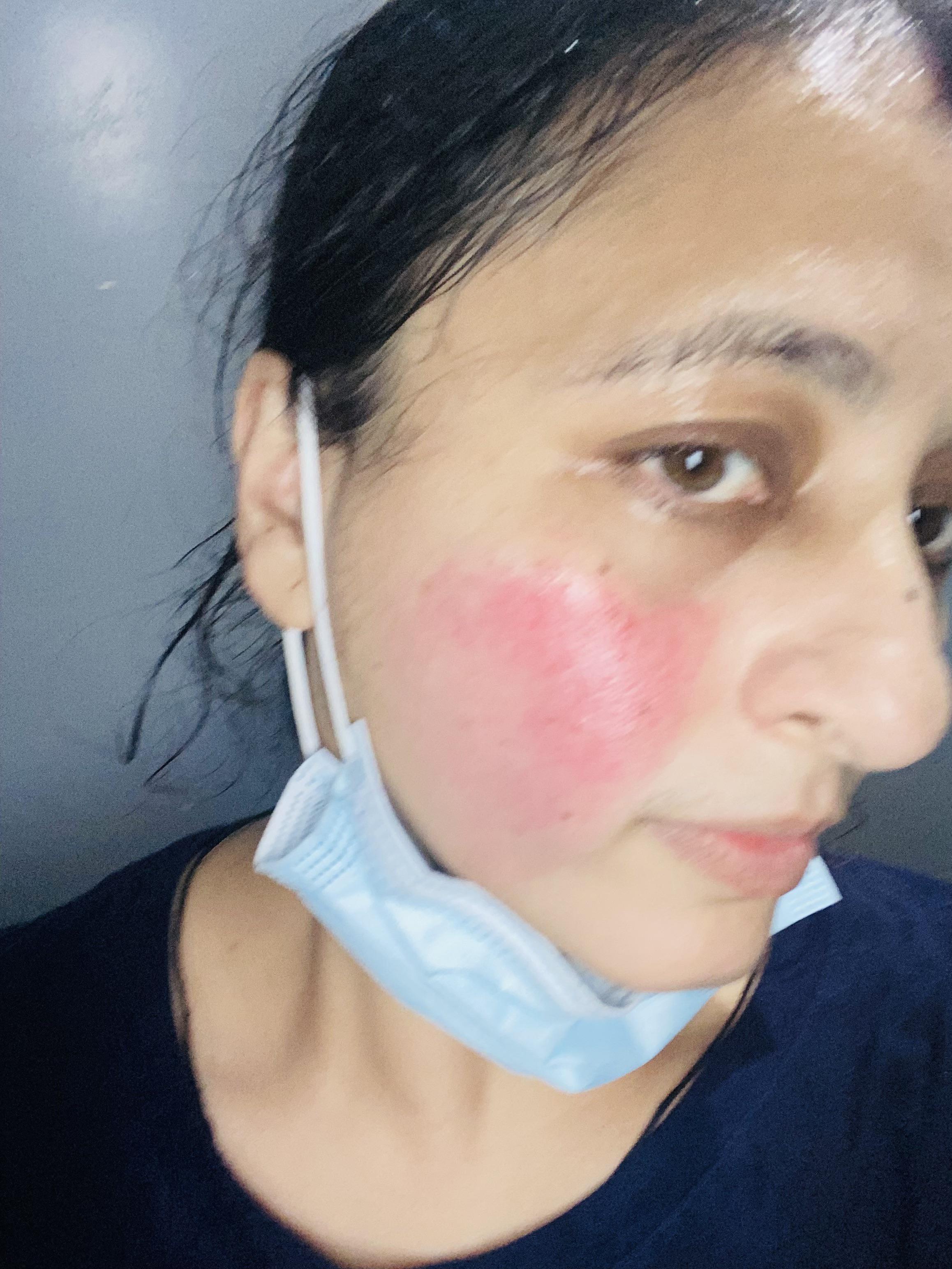 Frequent flare ups - burning - itching - redness of cheeks - | Scrolller