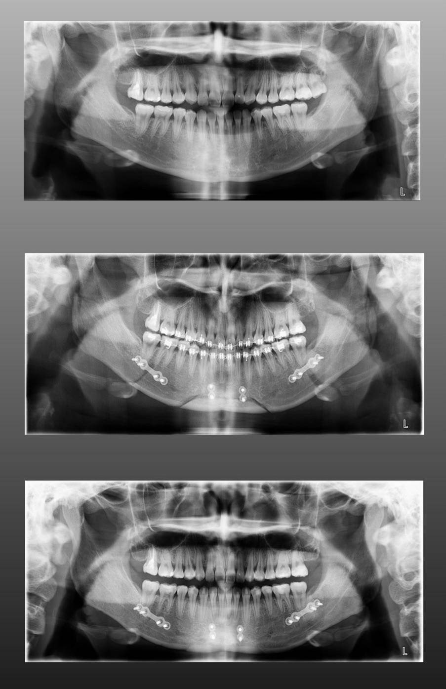 Fully healed X-rays | Scrolller