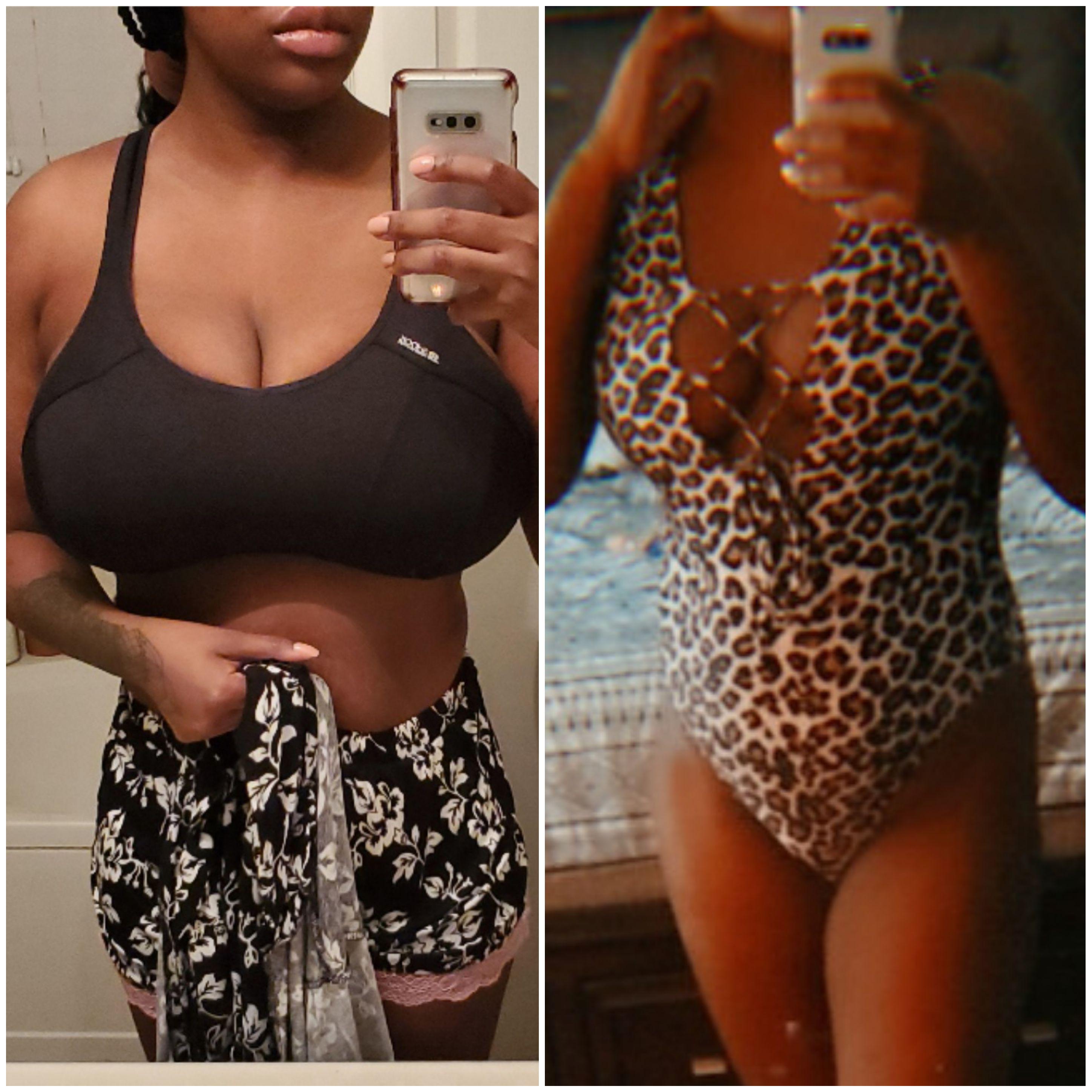 Happy 1 month post op to me!! | Scrolller