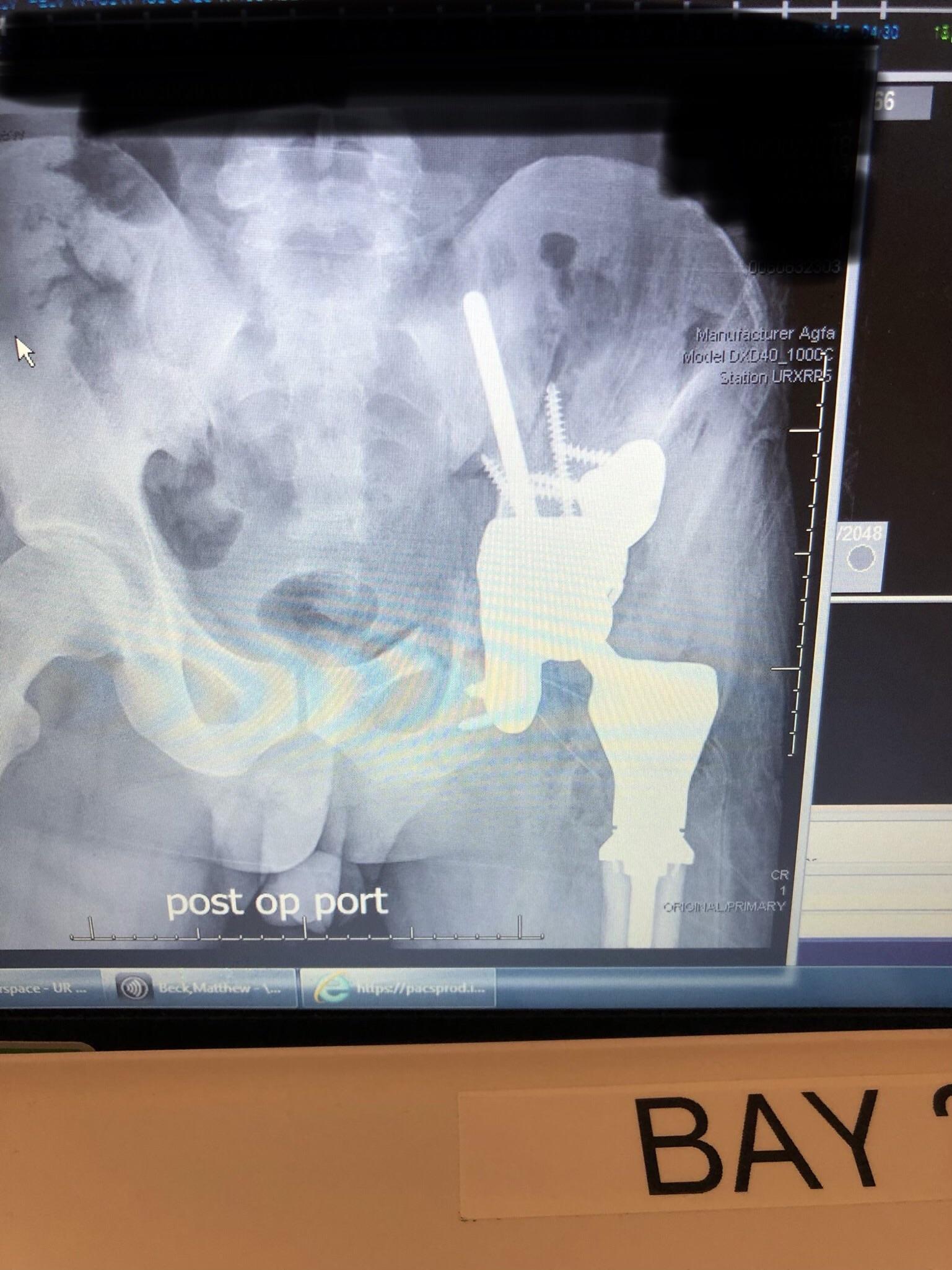 Hip after tumor removal and reconstruction | Scrolller