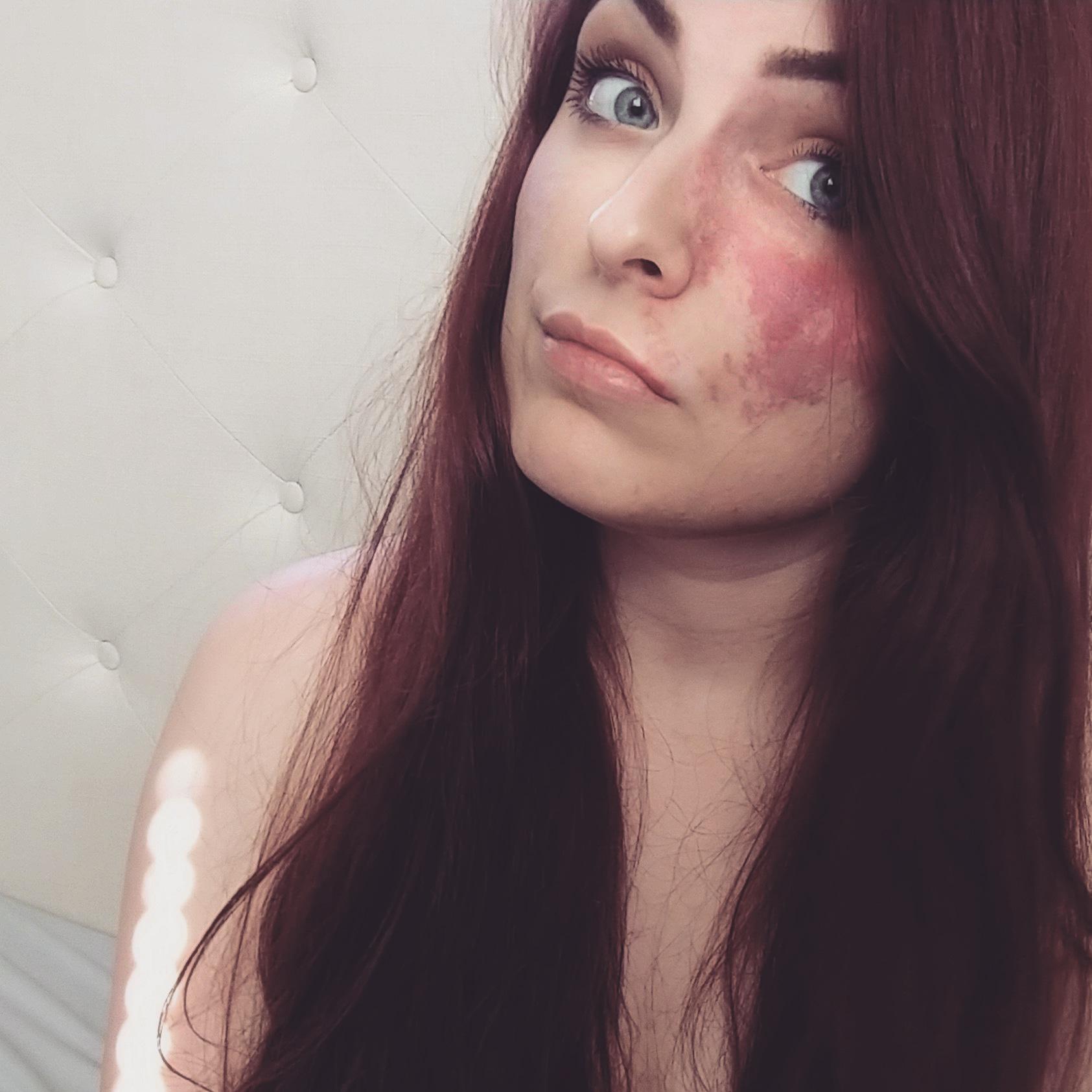 How Do You Handle Having A Facial Birthmark Scrolller