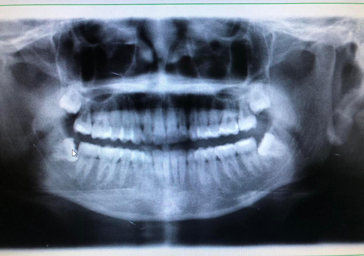 I’m getting all four wisdom teeth removed at once 😬 | Scrolller