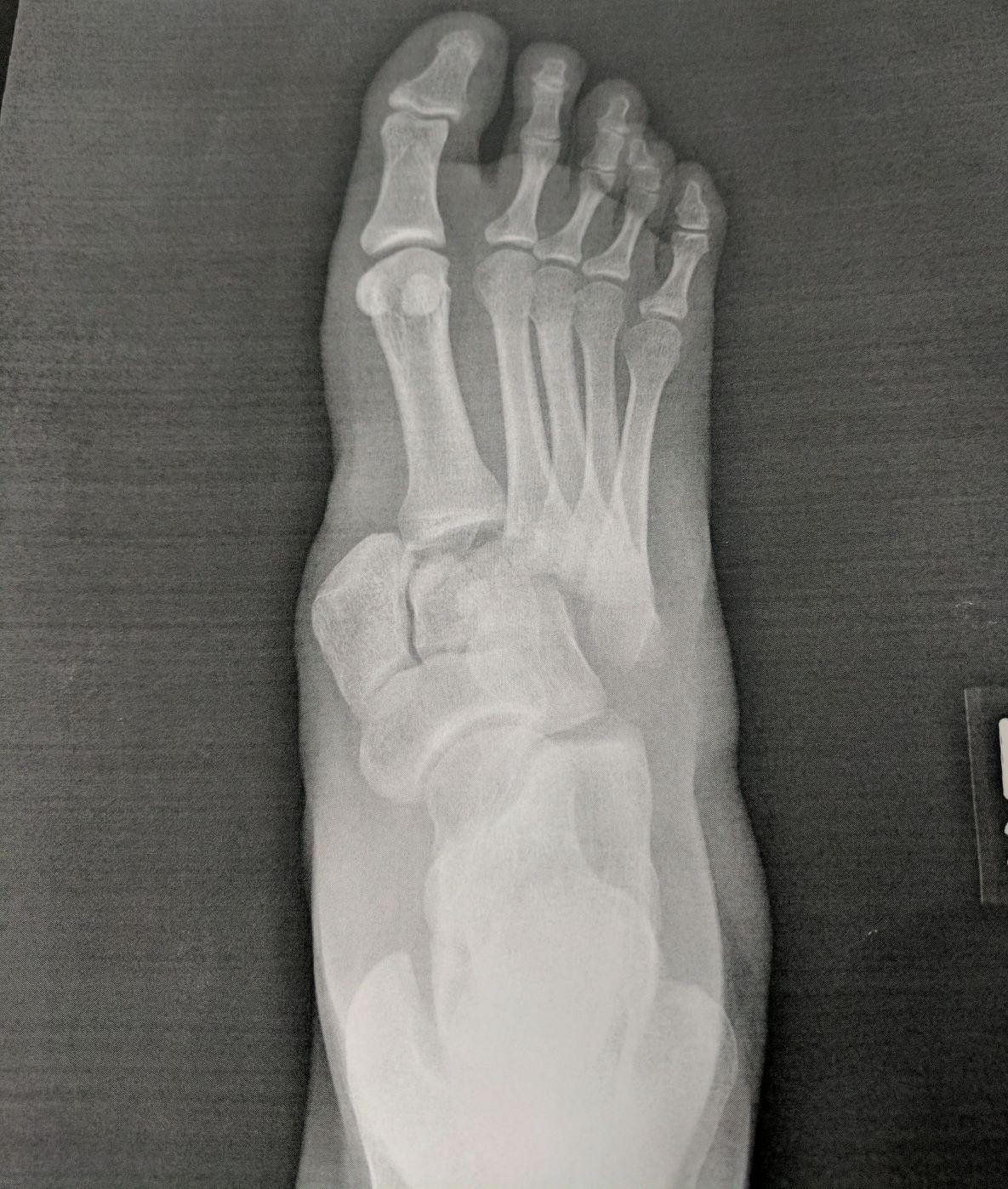 I see your x-rays and raise you five dislocated metatarsals | Scrolller