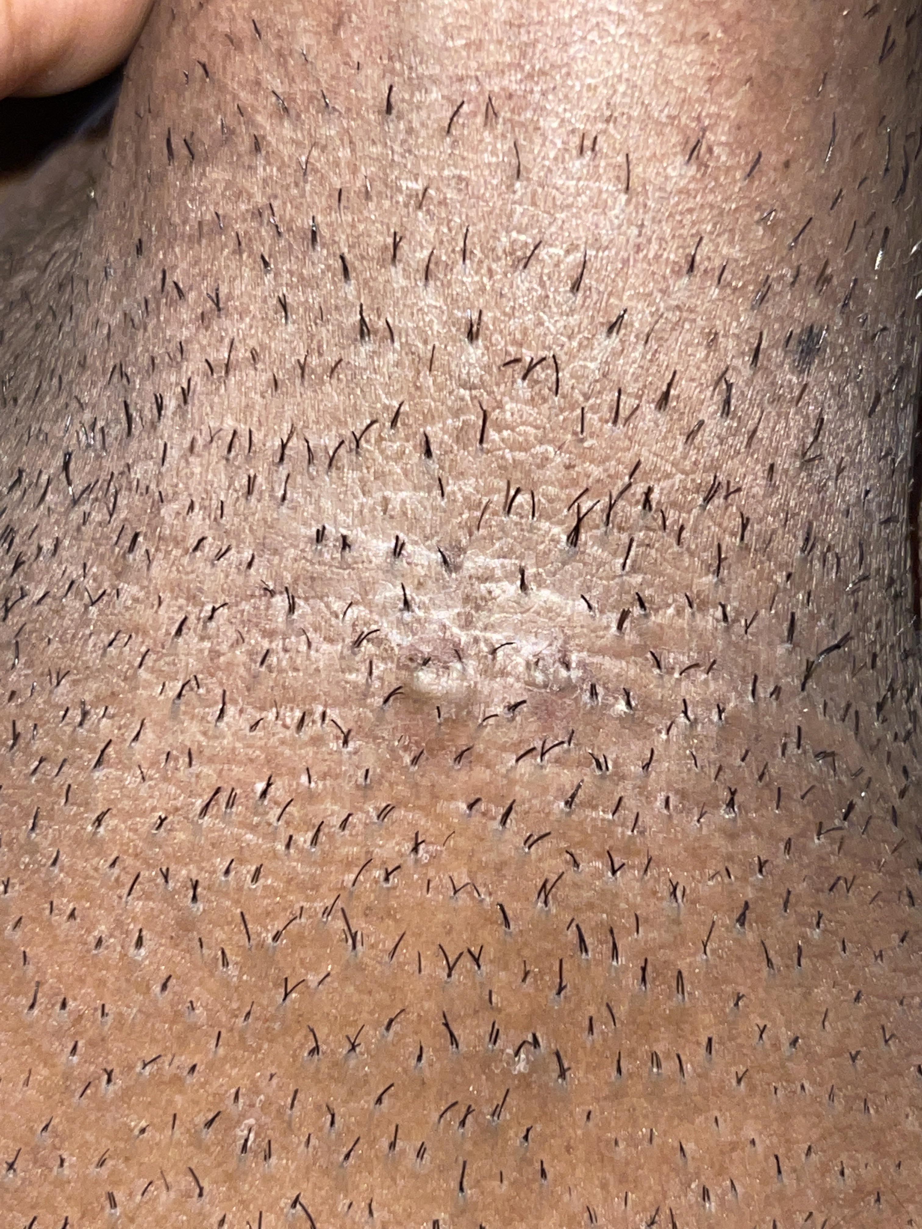Ingrown hair? Hair bump? Just a pimple? Cut bump? If so how do I remove it? I’m a virgin so I ...