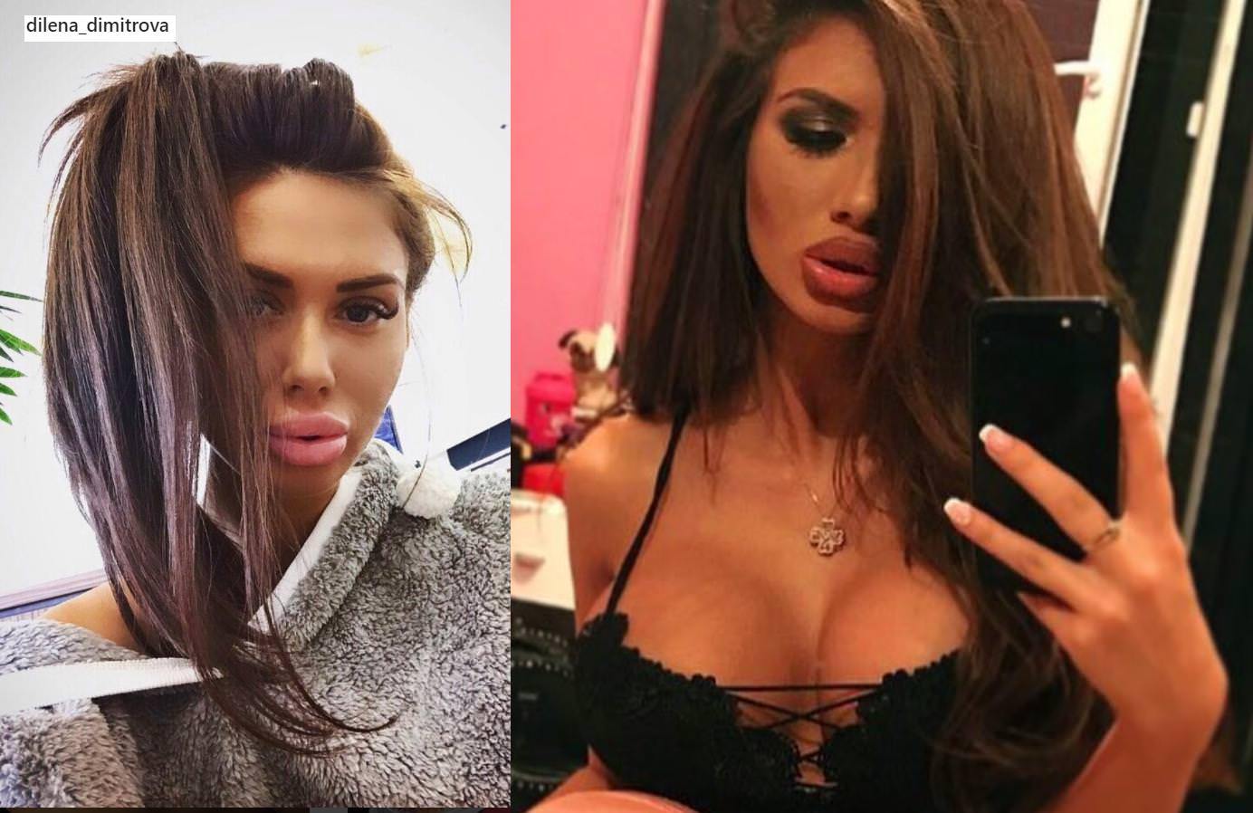 Injected lips | Scrolller