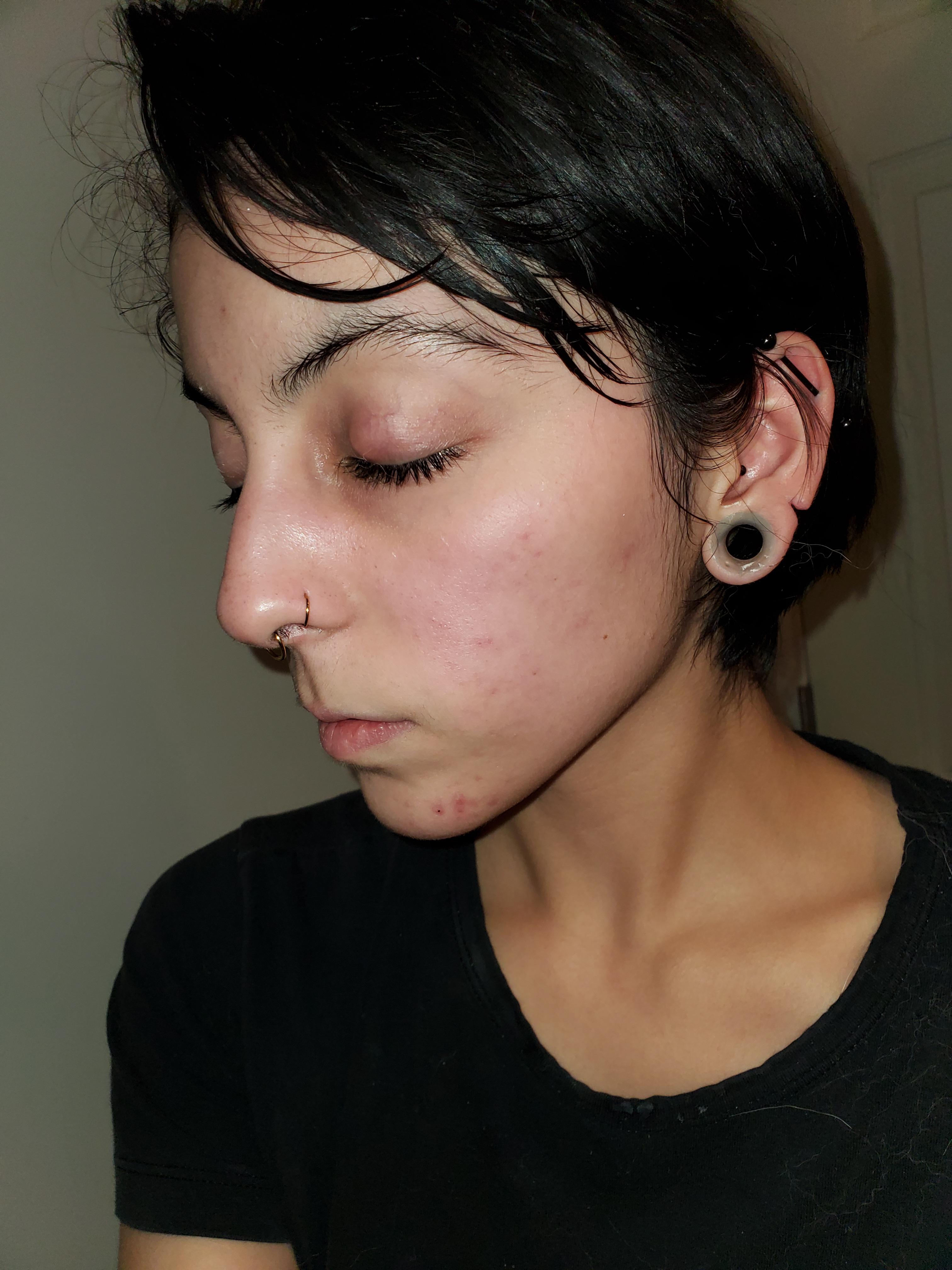 ive been struggling with acne for years now but heres my skin!!!! | Scrolller