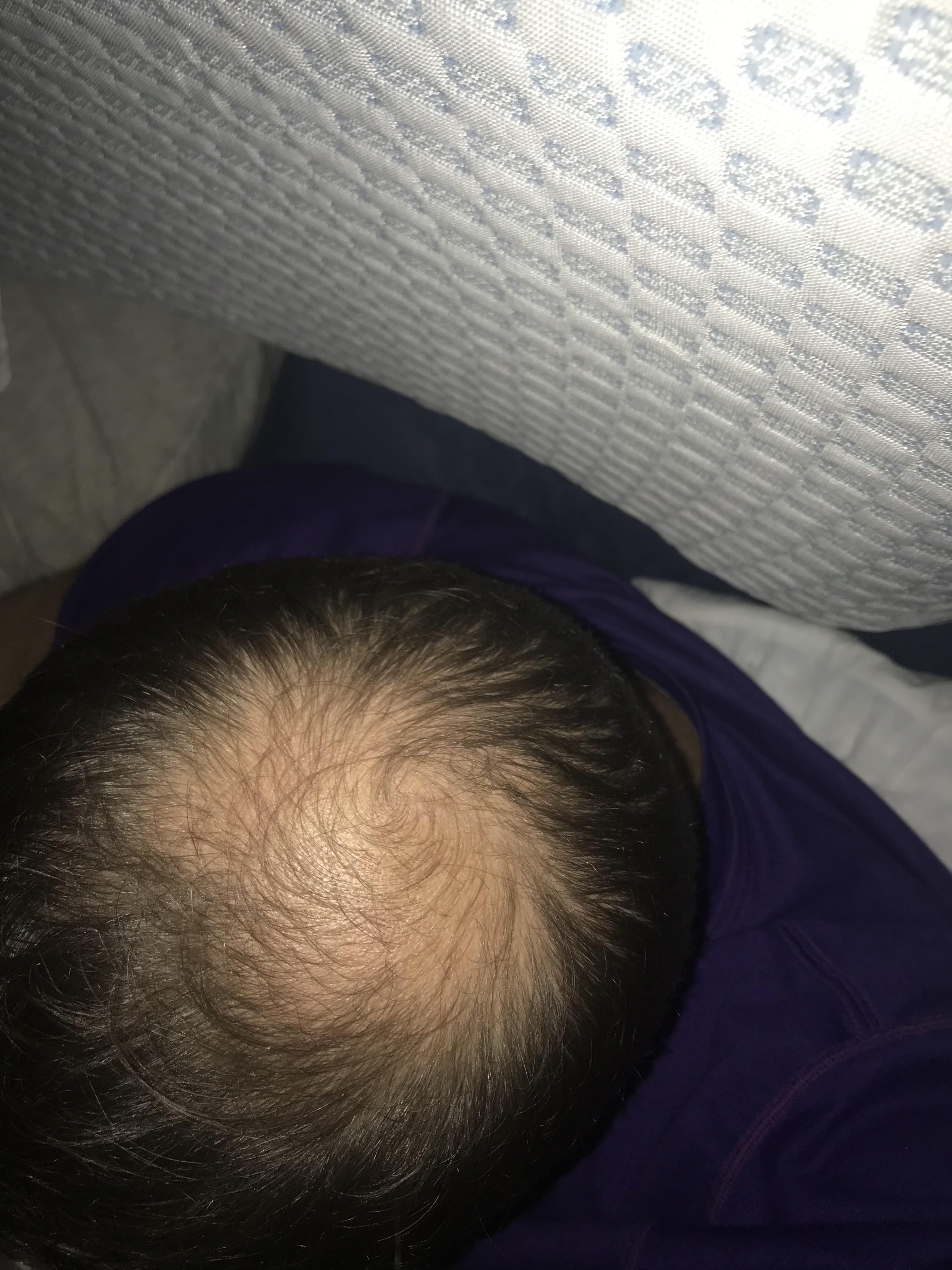 Just ordered fin and min. Will post progress. Wish me follicles.. | Scrolller