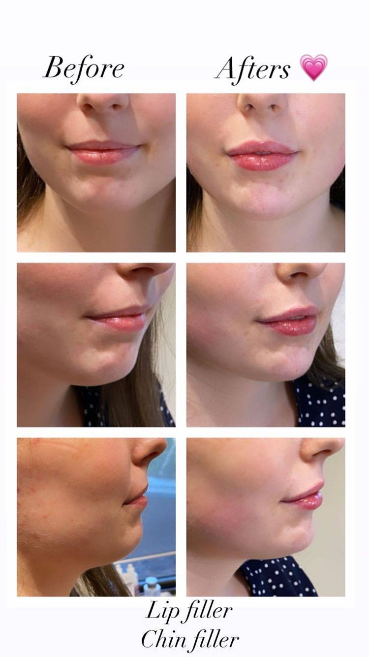 Lip and chin filler before and after | Scrolller