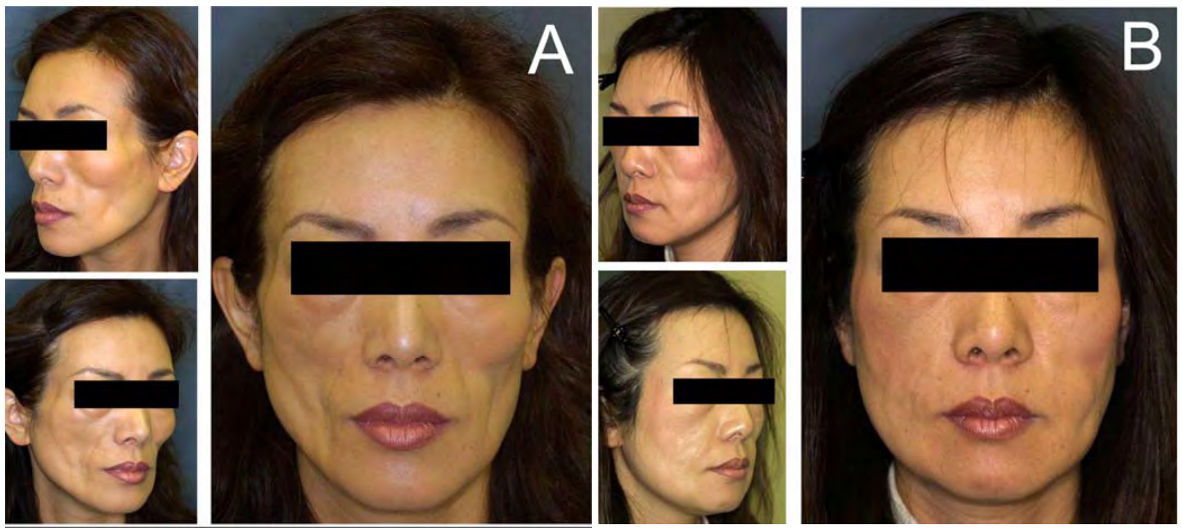 Lipoinjections for lipoatrophy due to Lupus erythematodes profundus | Scrolller