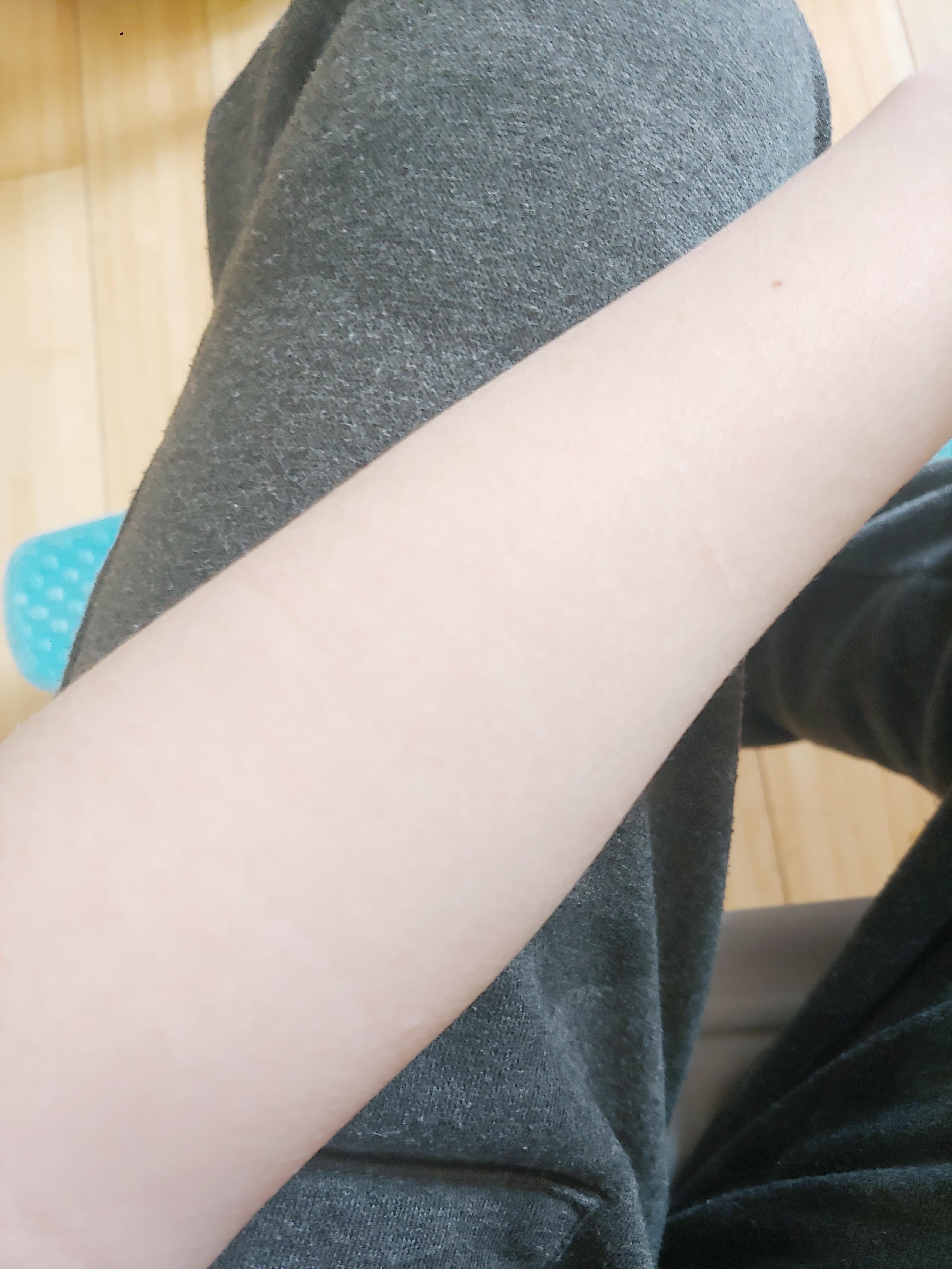 My scars finally healed up!! | Scrolller