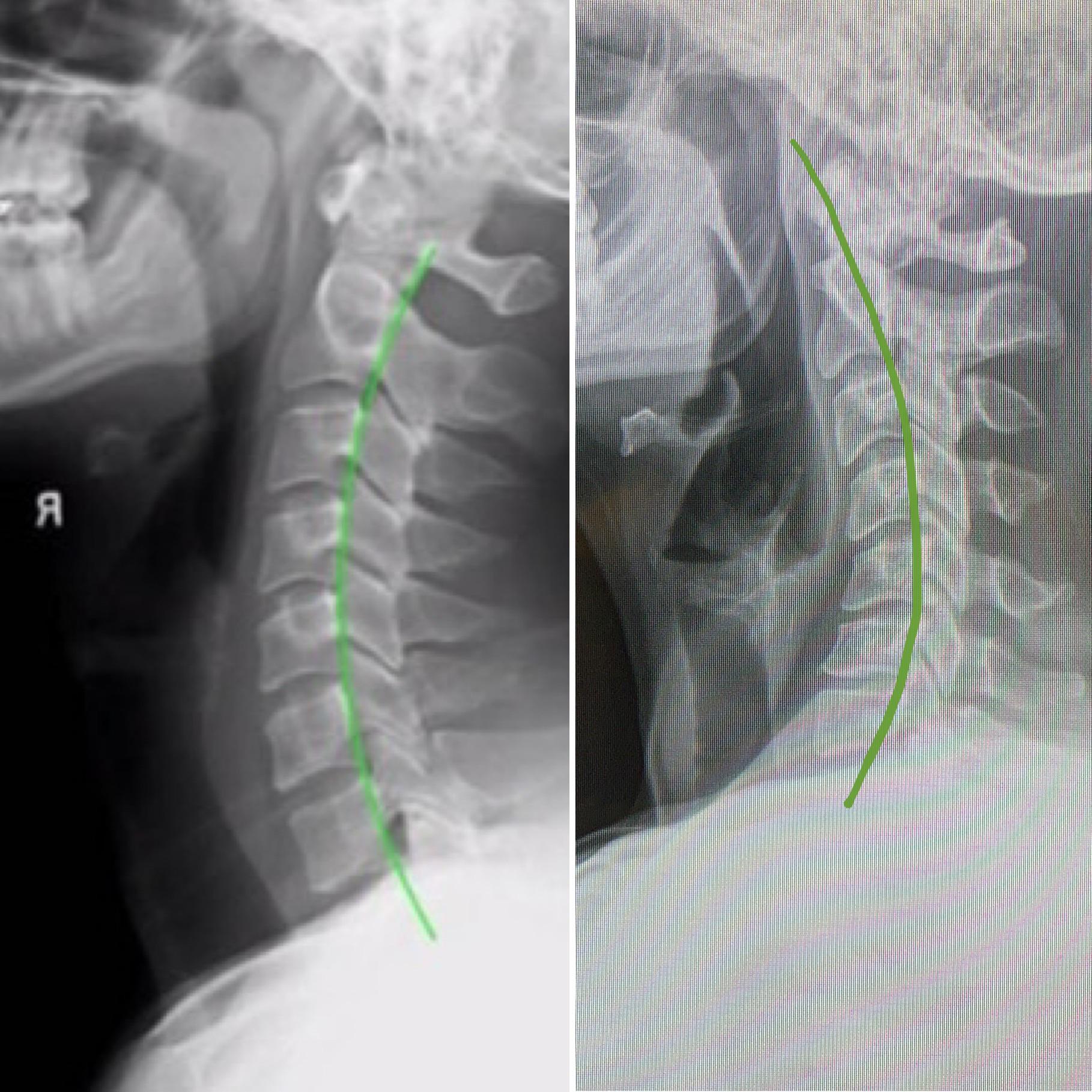 Normal cervical spine x-ray vs. my own | Scrolller