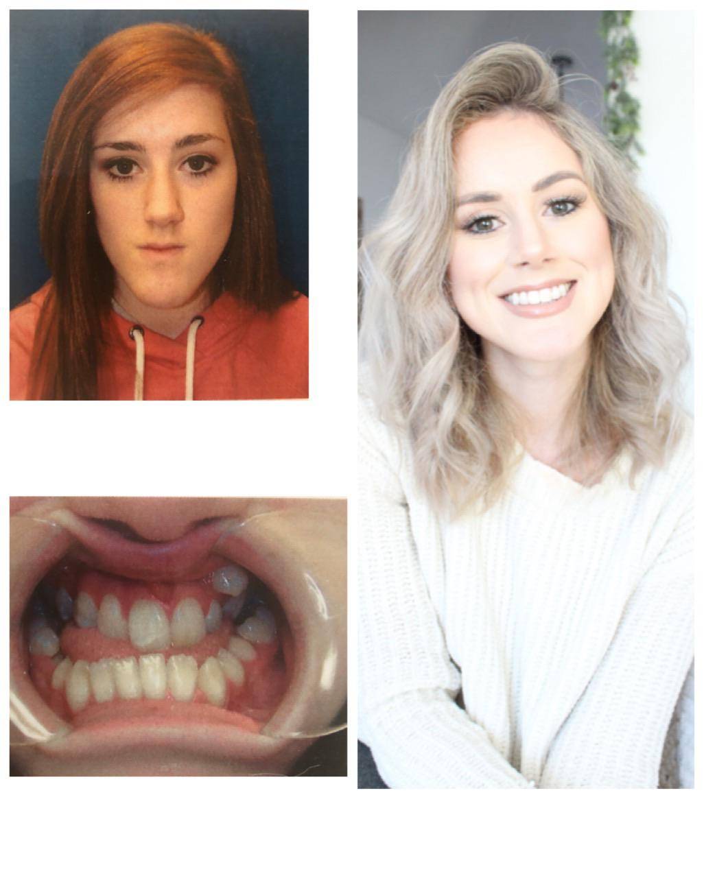 Braces Pictures Scrolller