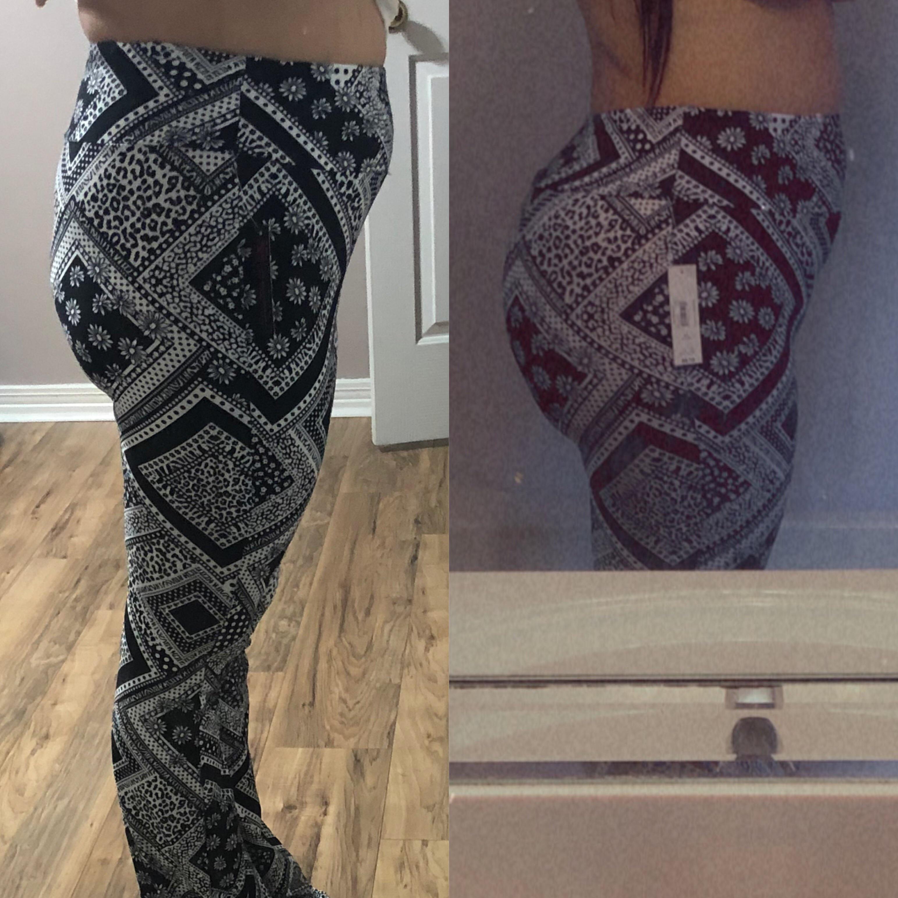 One week post op BBL | Scrolller