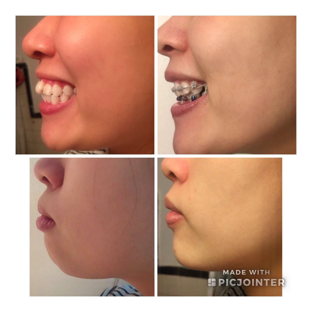 One year progress! | Scrolller