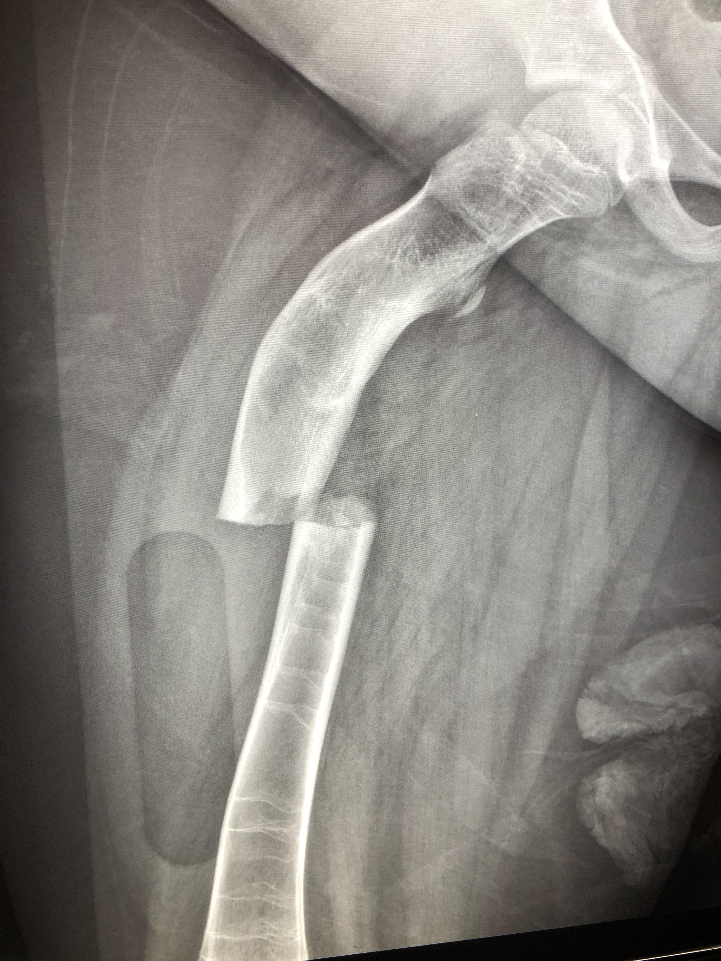 Osteogenesis Imperfecta femur fracture | Scrolller