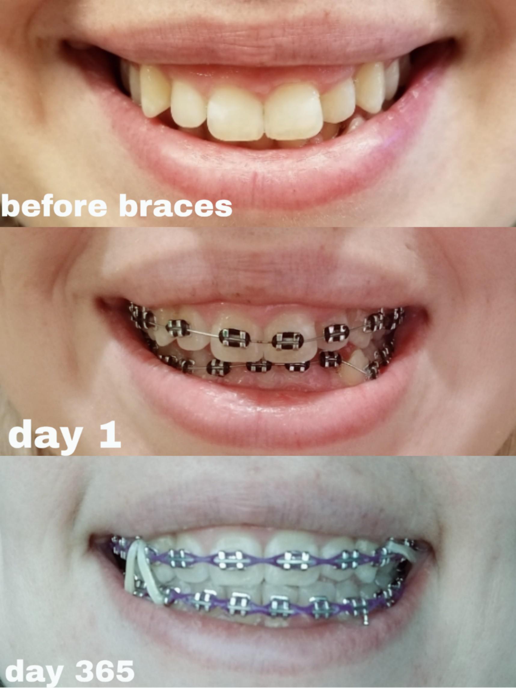 Progress from the past year with braces on. One year down, one year to go 🎉🎉 | Scrolller
