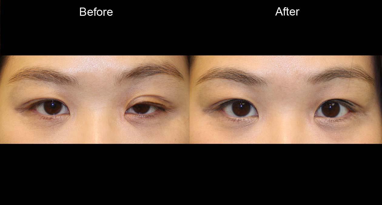 Ptosis correction | Scrolller