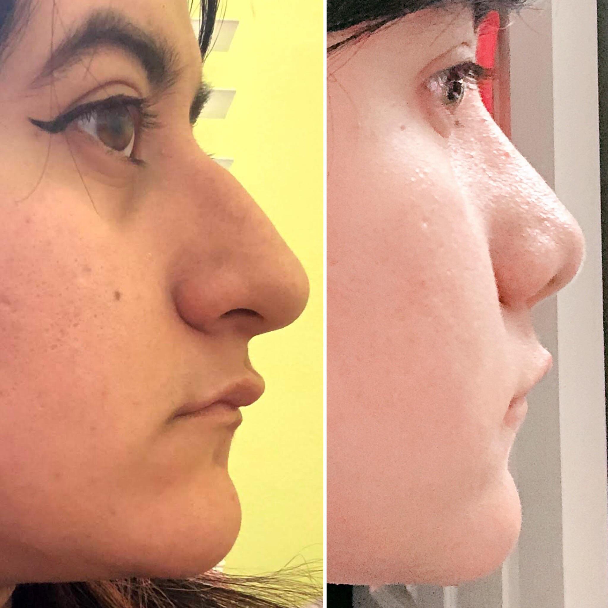 Rhinoplasty || Pre-Op VS 1 Month Post-Op || Surgeon: Dr. Robert Kotler | Scrolller