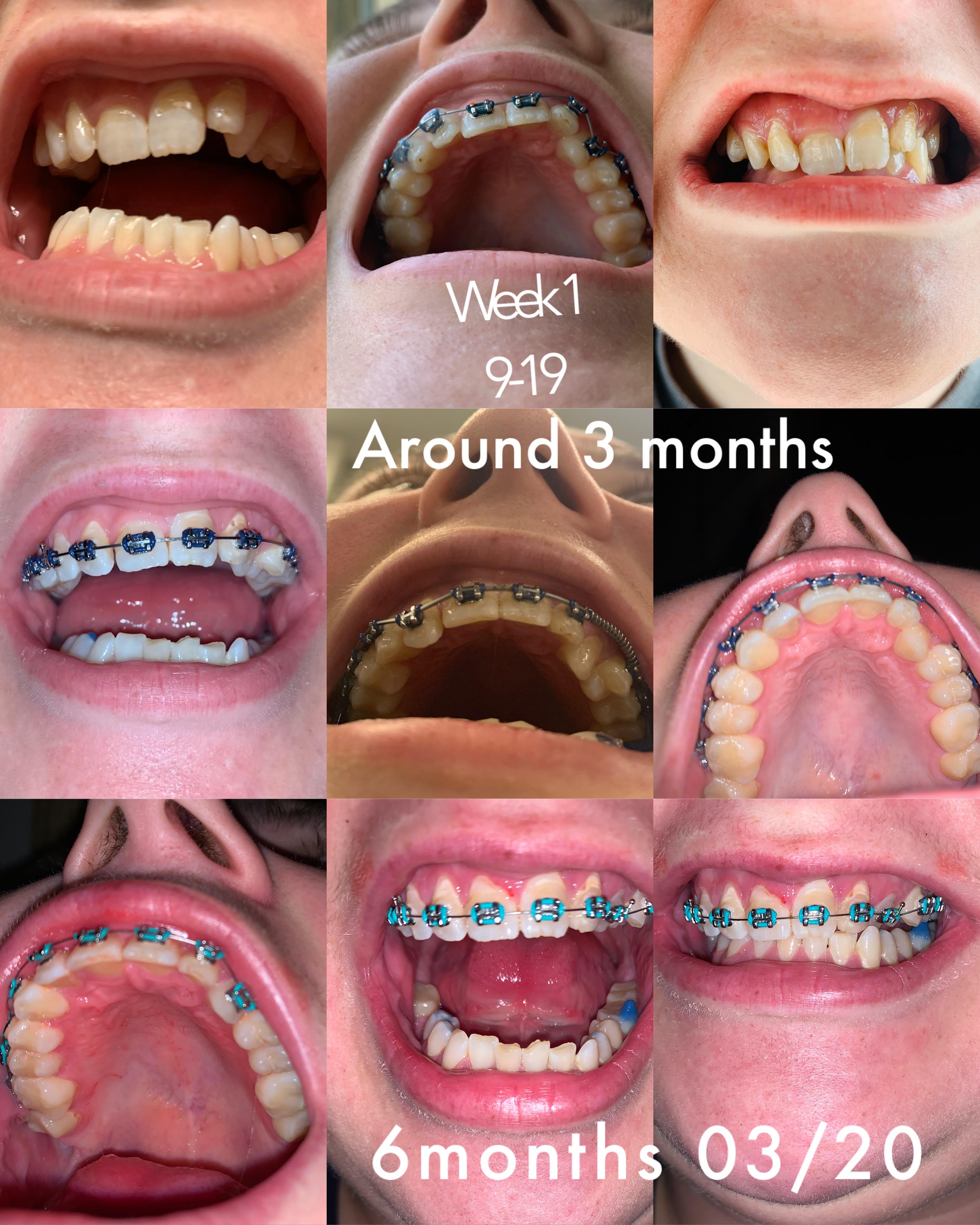 Slowly but surely. They finally bonded the snaggle tooth so that I can get the lowers bonded ...