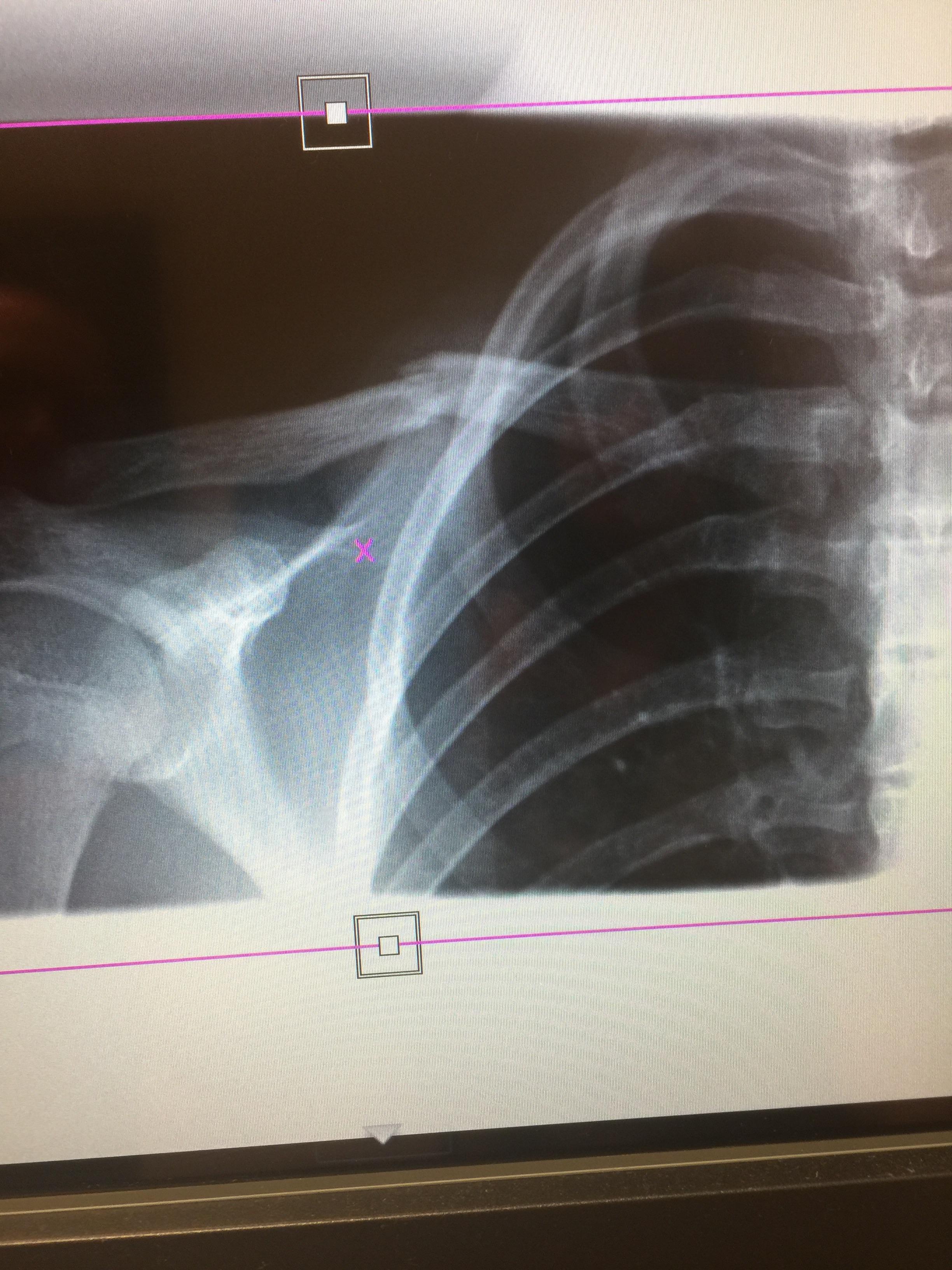 Snapped my collarbone playing hockey | Scrolller