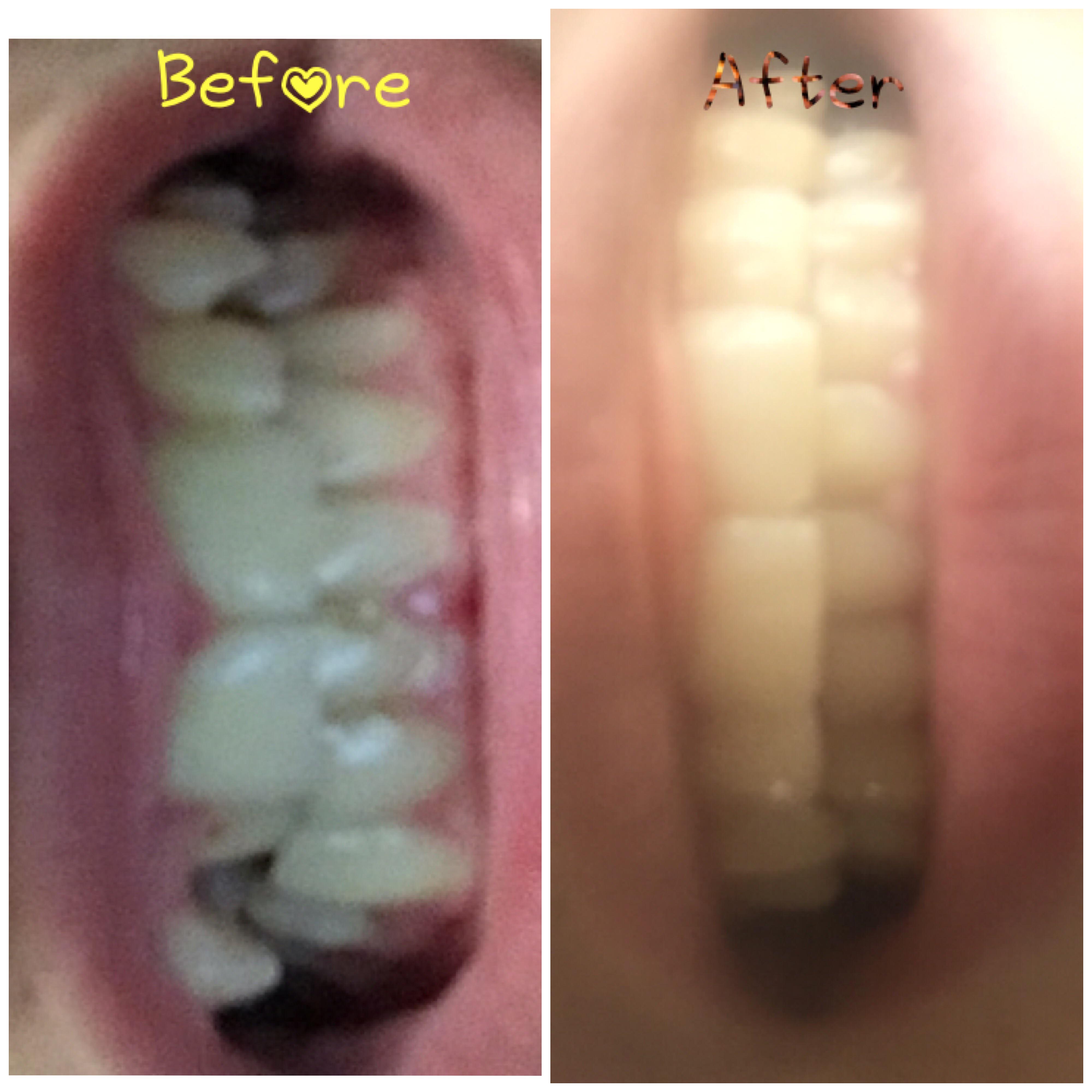 teeth before and after braces! | Scrolller