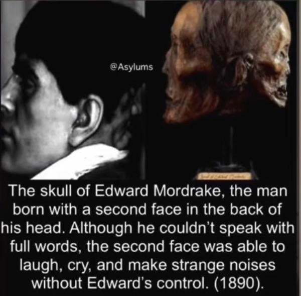Skull of Edward Mordrake | Scrolller