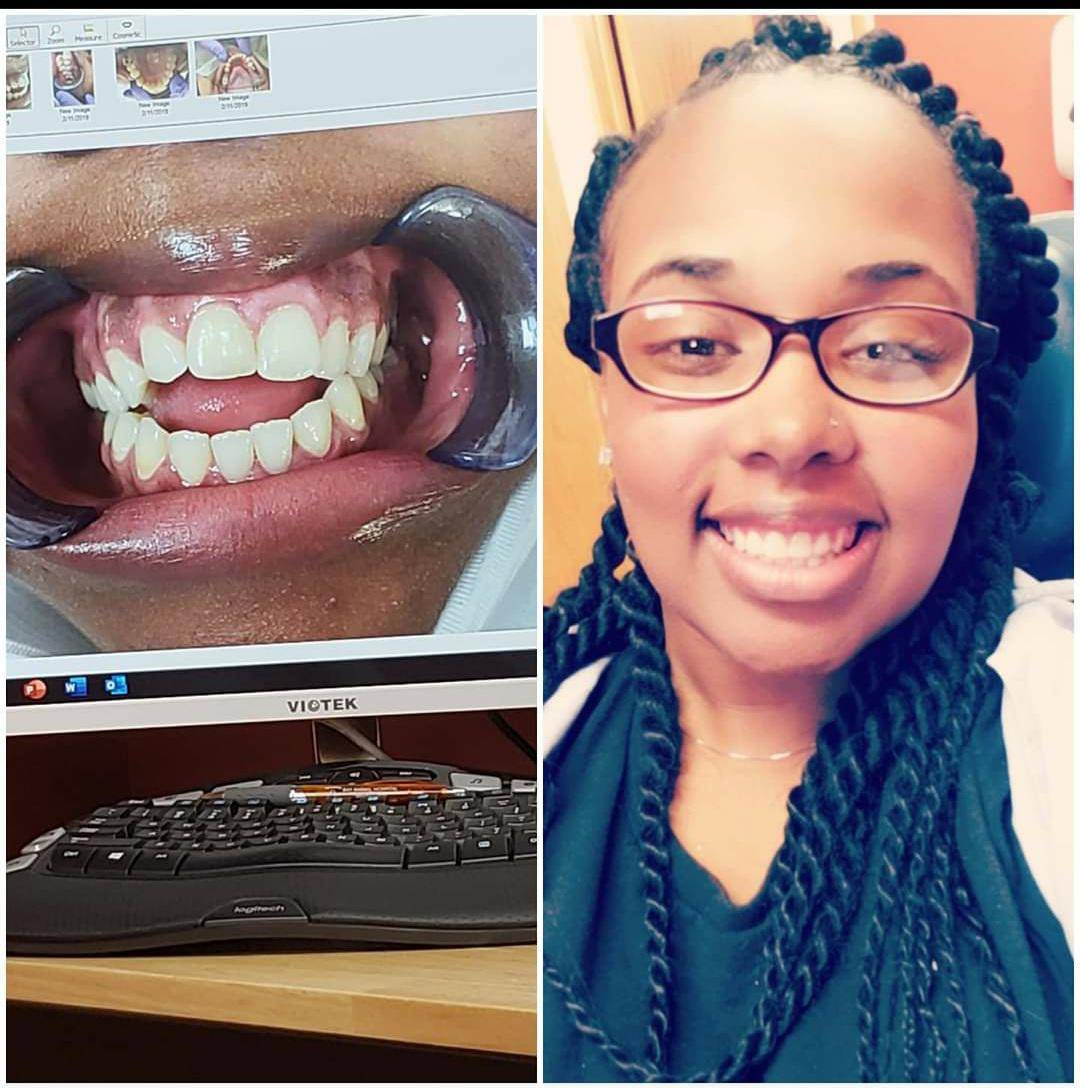 Thumb sucker here so excited finally got brace off | Scrolller